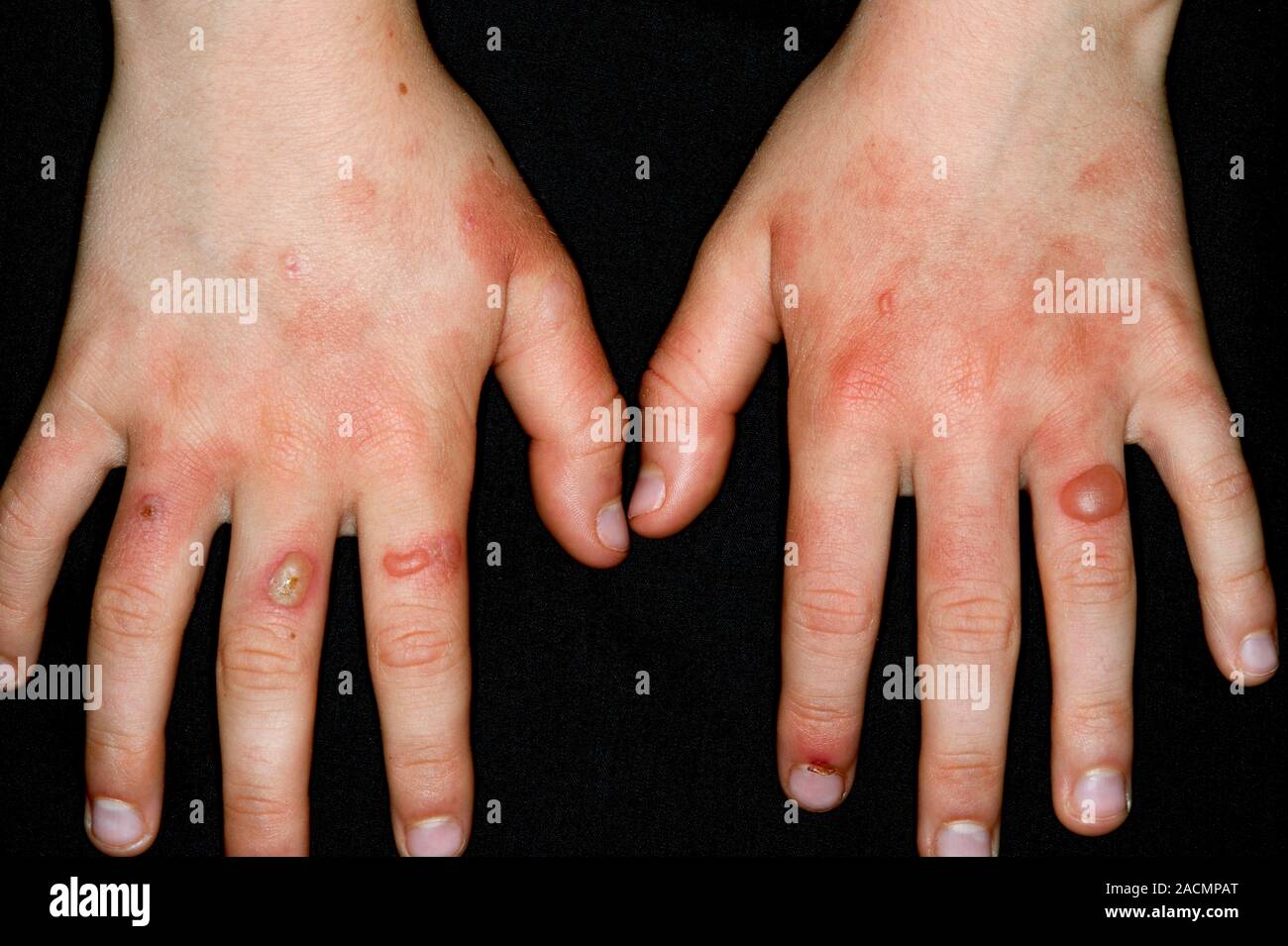 Rash and blistering on the hands in a 9 year old male patient with a ...