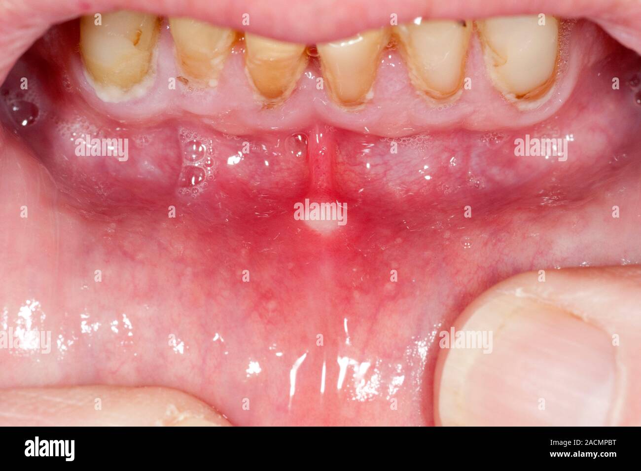 Close-up of an aphthous ulcer on the inside of the lip in a 77 year old ...
