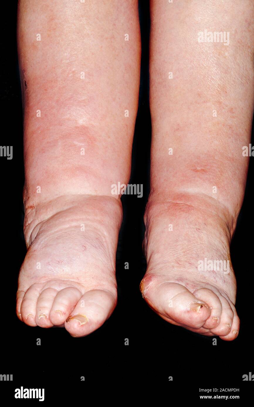 Bilateral Swelling Of The Lower Limbs legs Ankles And Feet Due To Bilateral Swelling Of The Lower Limbs legs Ankles And Feet Due To