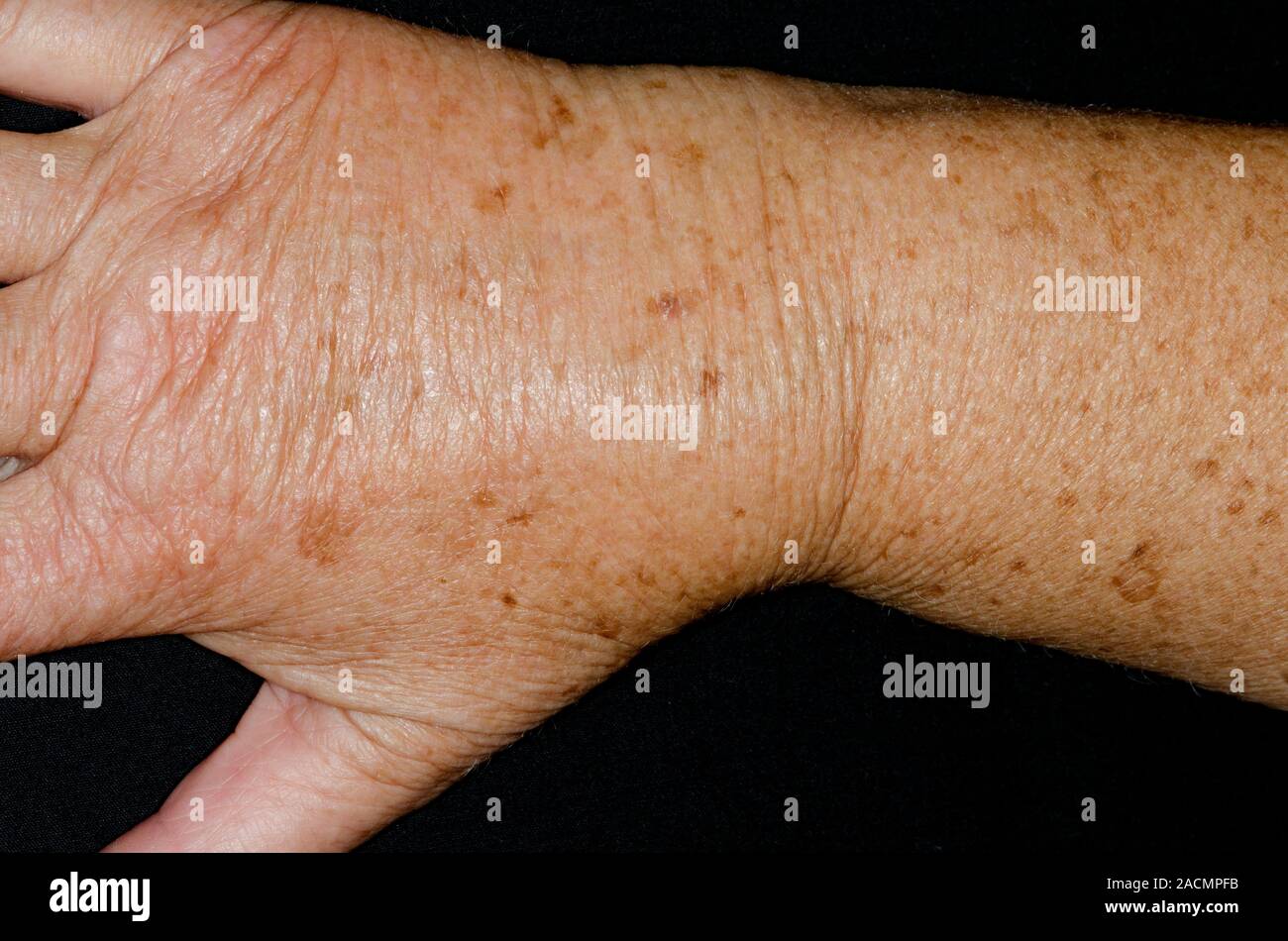 Swollen wrist in a 75 year old female patient due to osteoarthritis, a ...