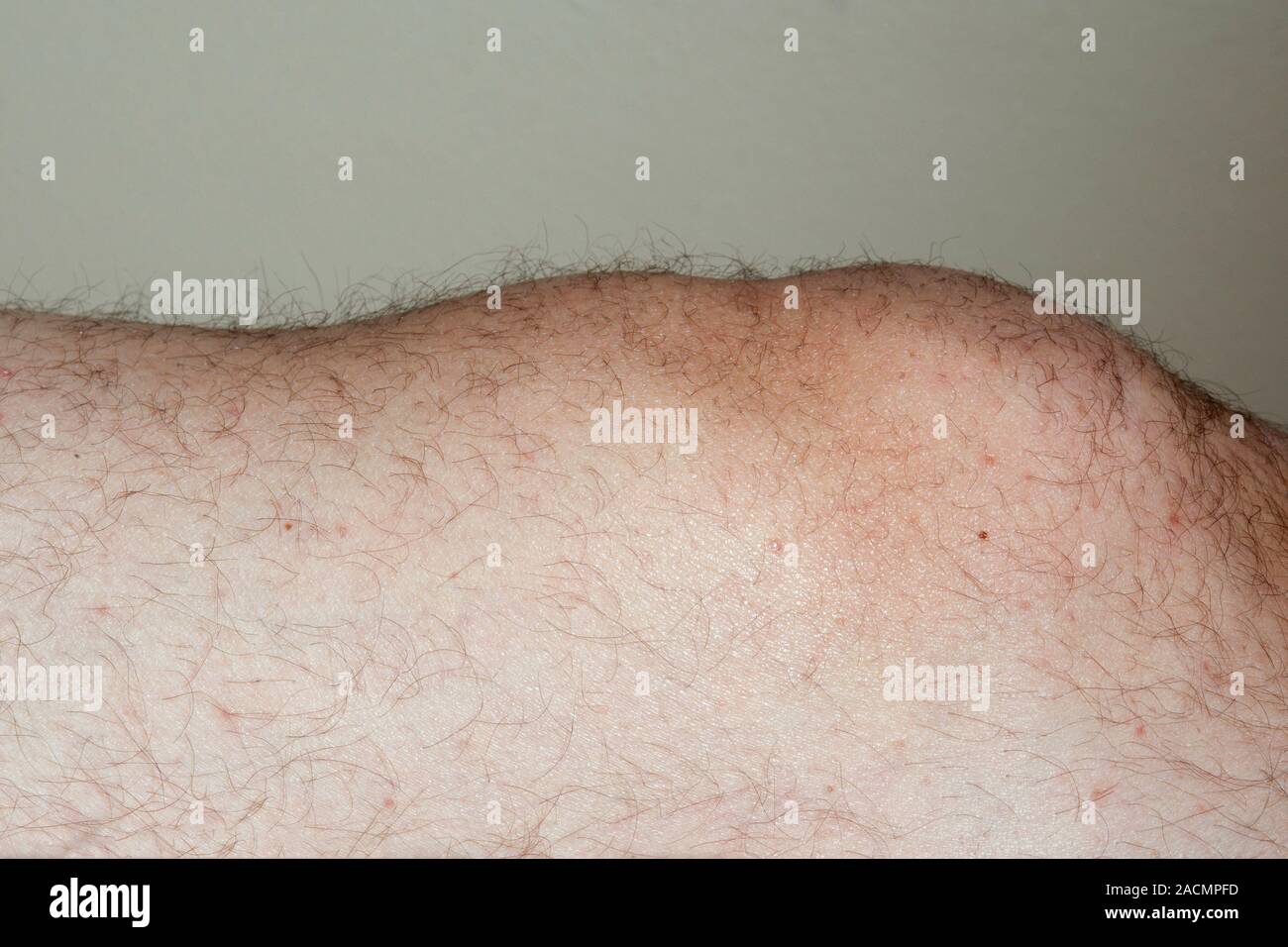 Swollen knee with effusion (fluid in the joint) in a 35 year old male ...