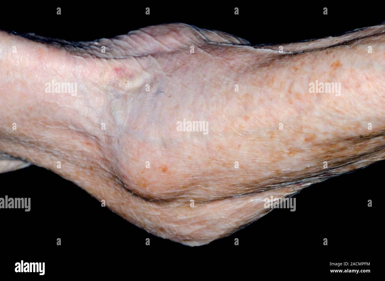 Swollen and deformed elbow joint in an 88 year old female patient due ...