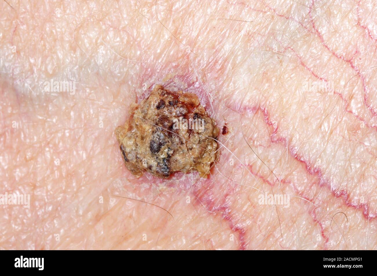 Close-up of a scabbed squamous cell carcinoma on the scalp in a 92 year ...