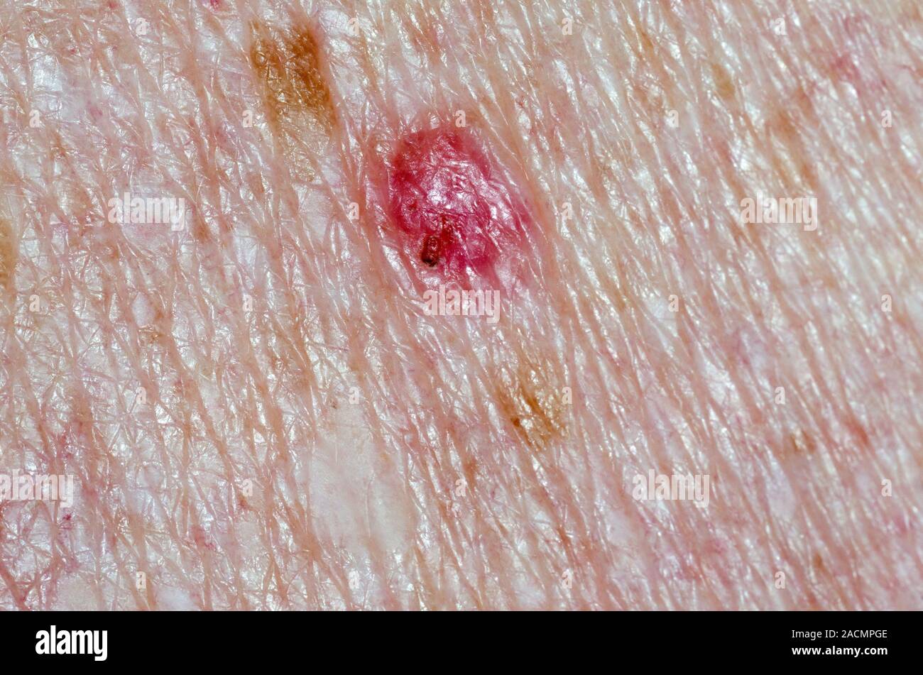 Close-up of basal cell carcinoma (BCC), or rodent ulcer, on the skin of ...