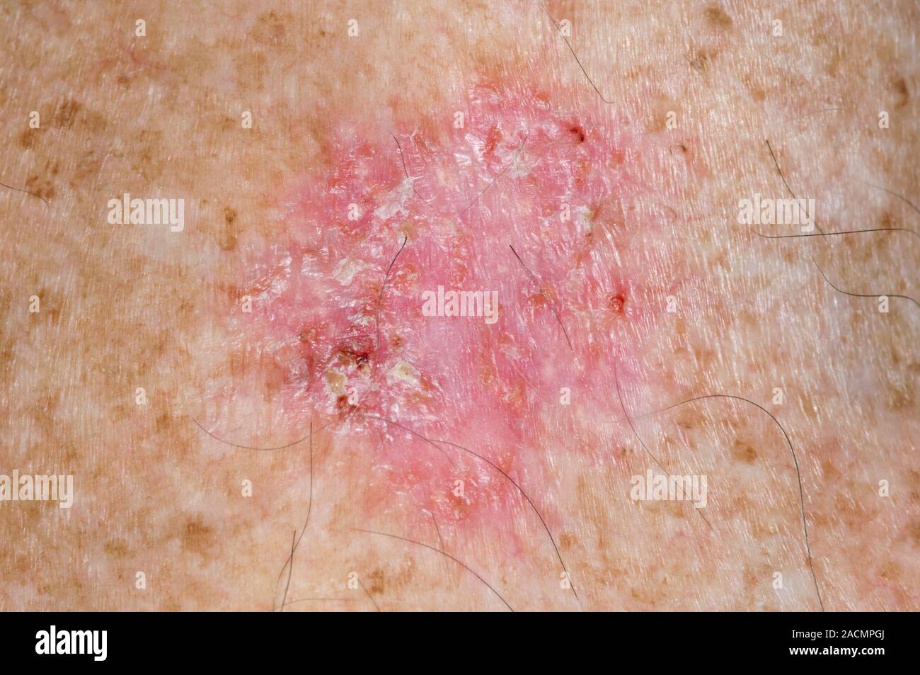 Close-up of squamous cell carcinoma on the skin of the shoulder in a 77 ...