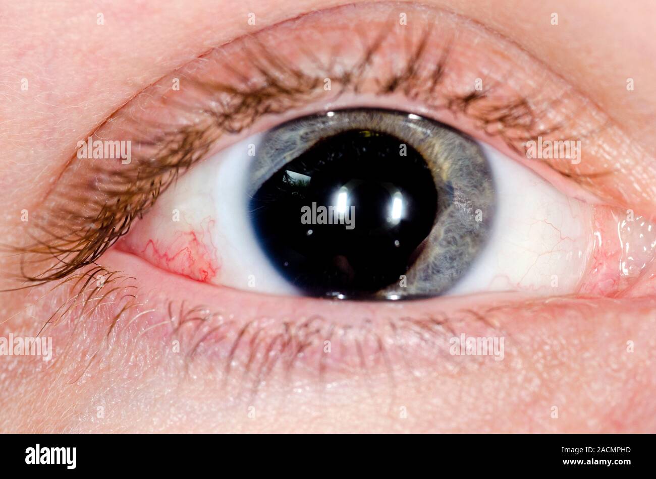 Eye injury in a 24 year old female patient showing post-surgical ...