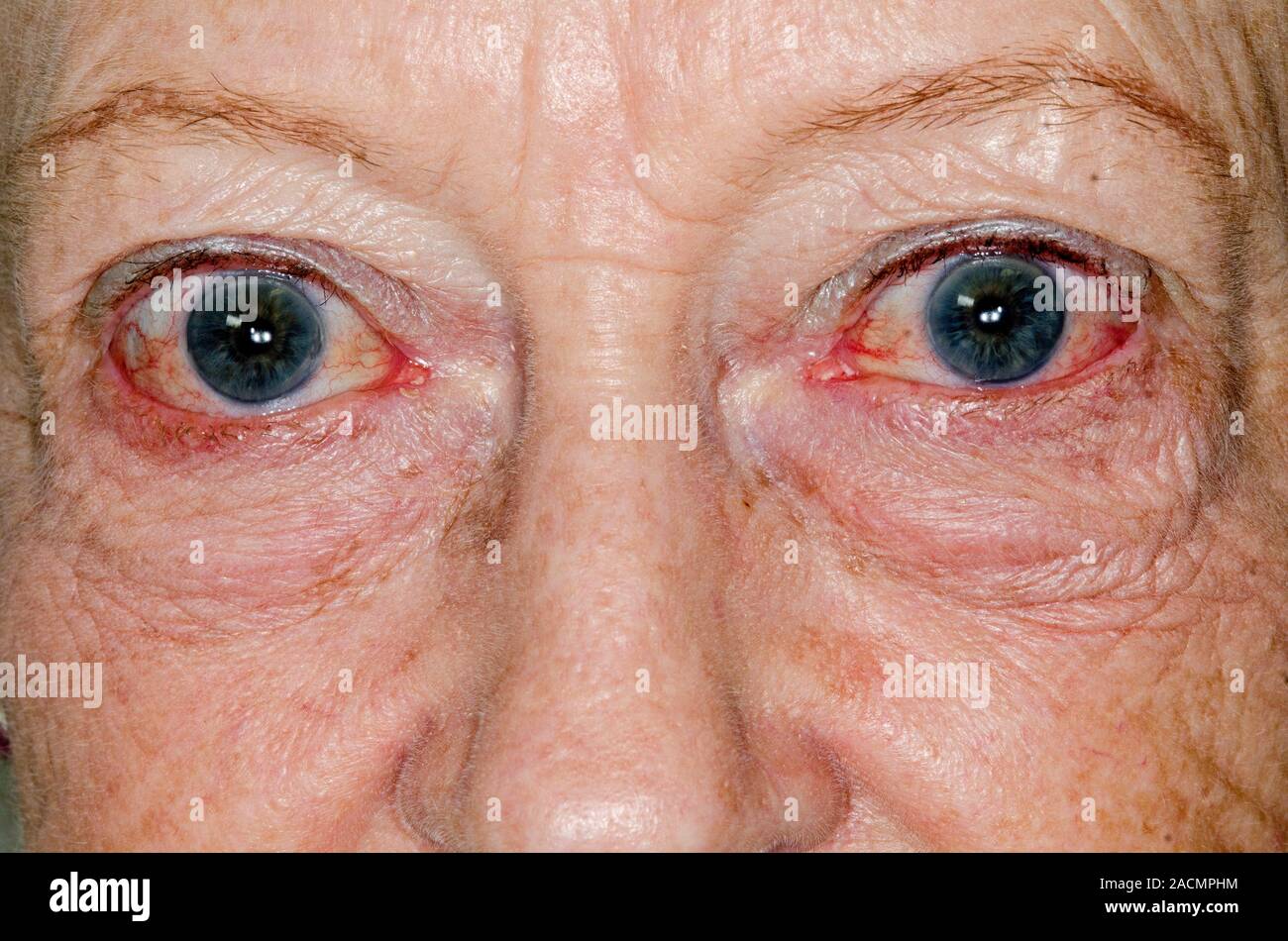 Bulging eyes (proptosis or exophthalmos) in a 79 year old female ...