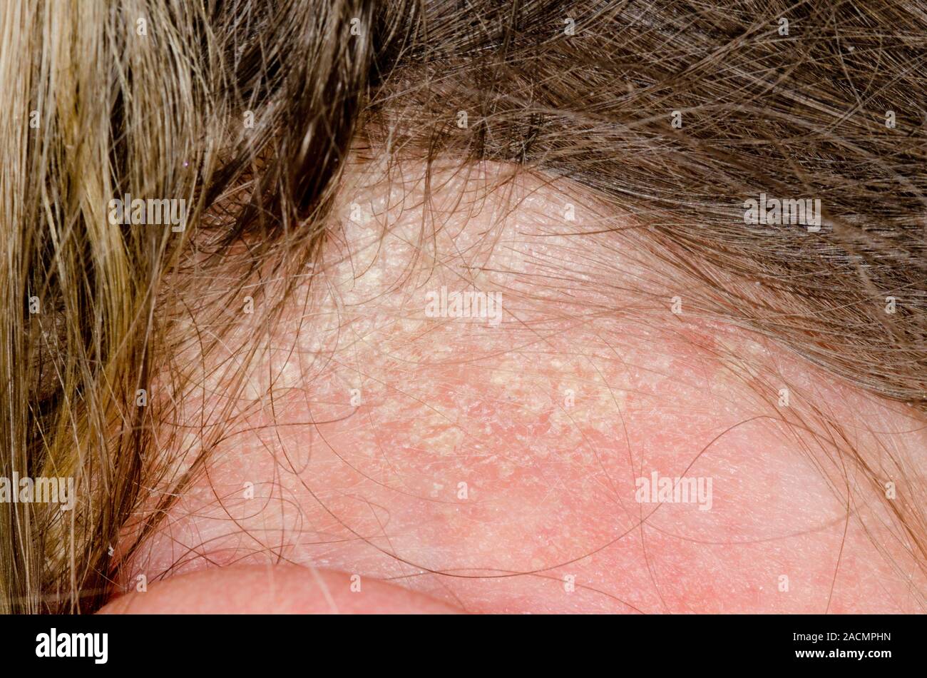 Flaking and scaling skin on the scalp in a 20 year old female patient ...