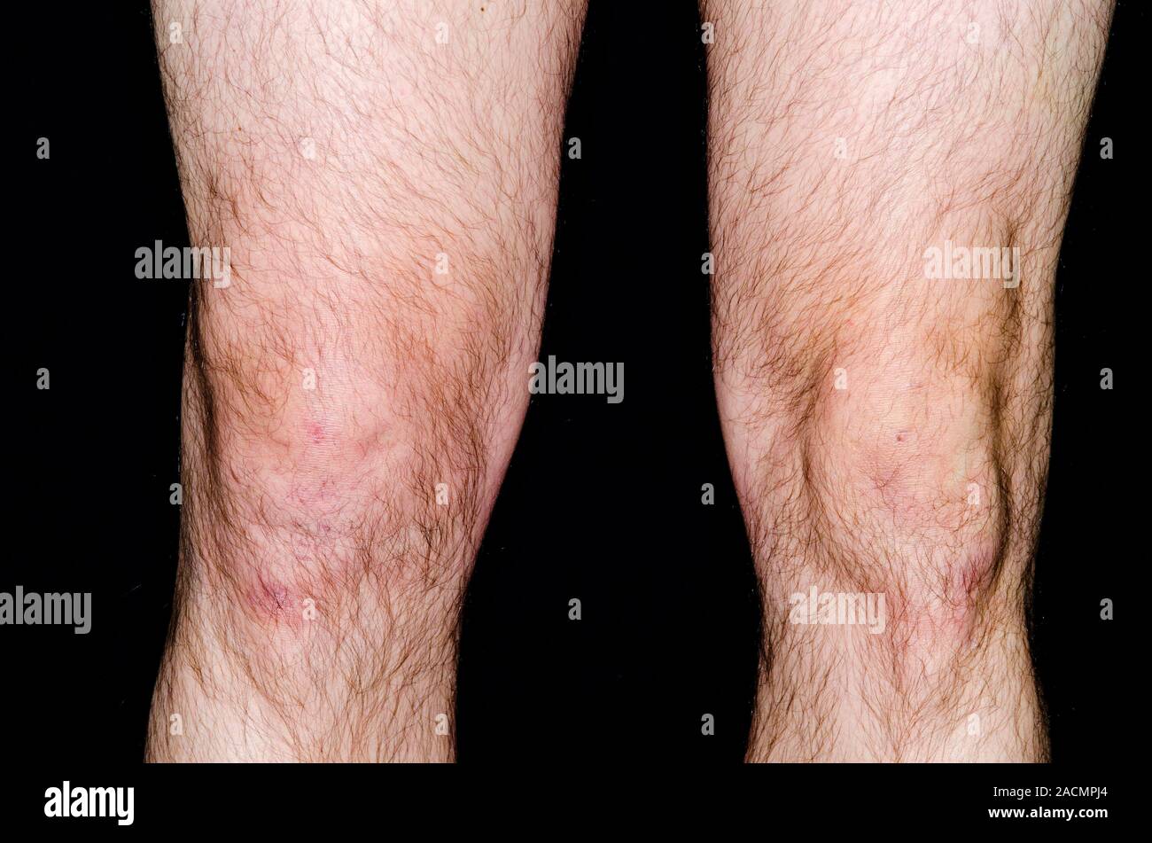 Swollen knee with effusion (fluid in the joint, at left) in a 44 year ...