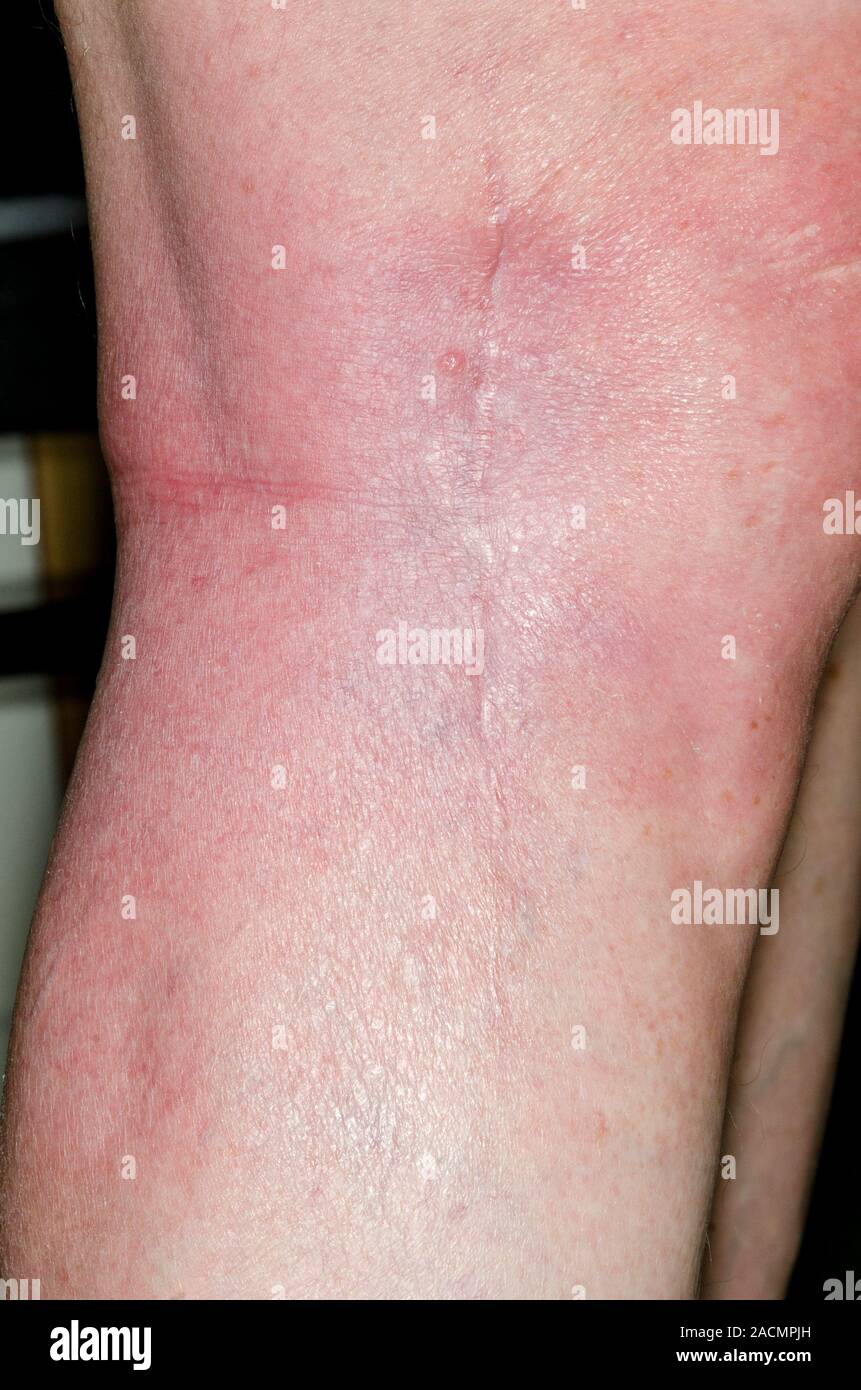 Scar on the side of the knee in a 67 year old male patient after ...