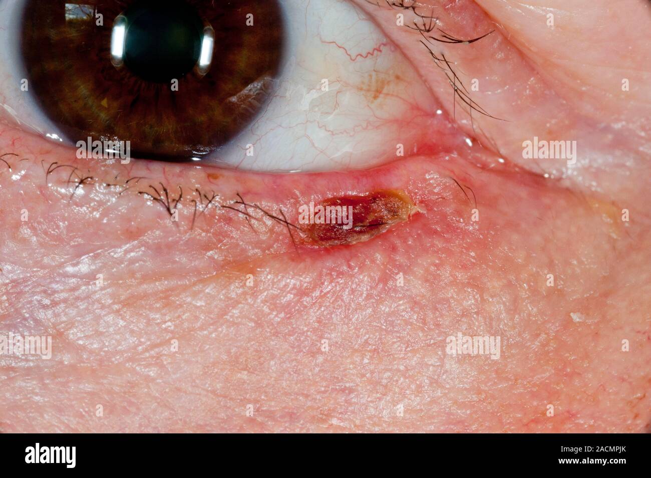 Basal Cell Carcinoma Eyelid Rodent Ulcer Basal Cell Carcinoma Archives