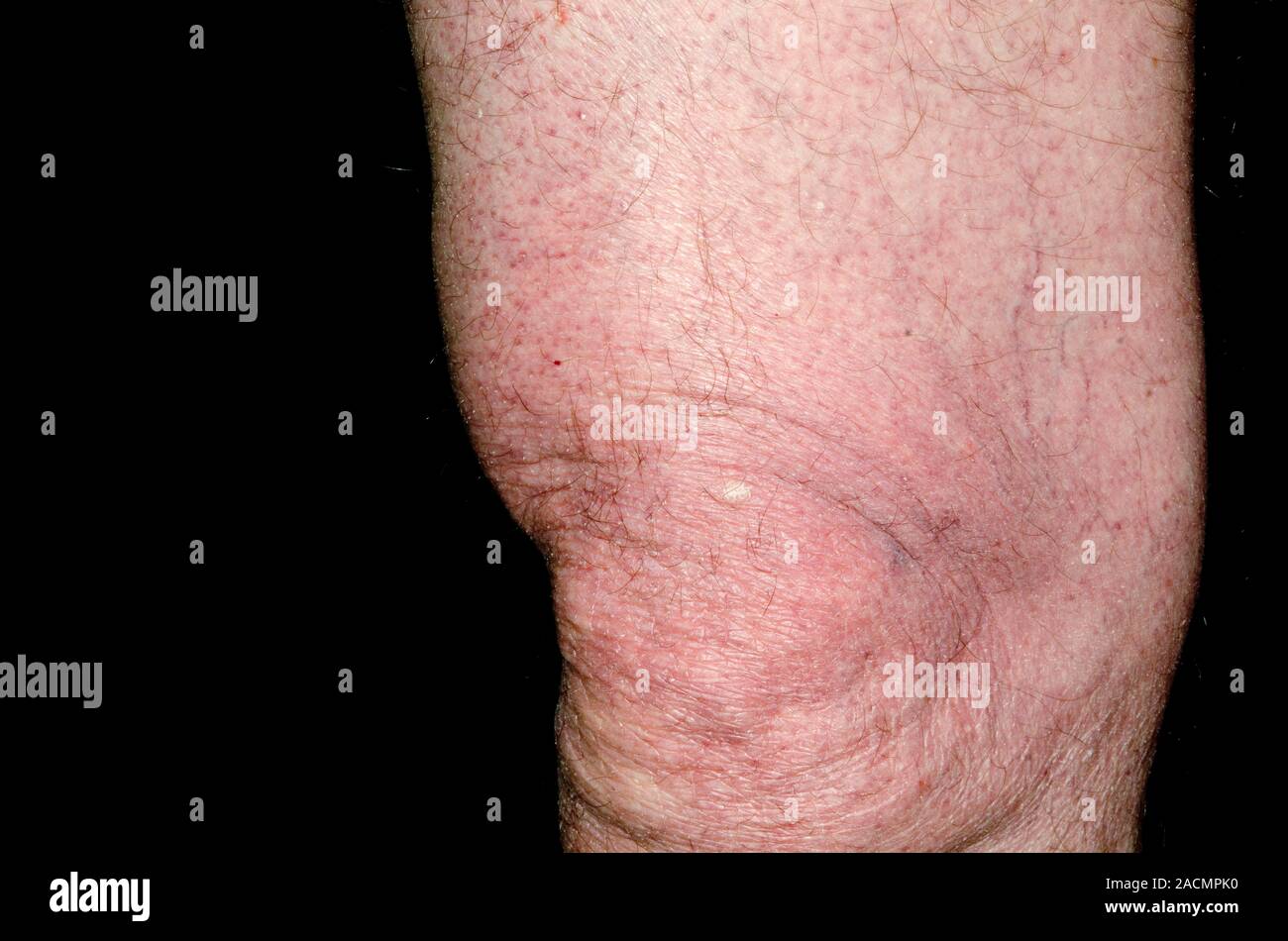Swelling due to a torn thigh muscle with bruising (haematoma) of the ...