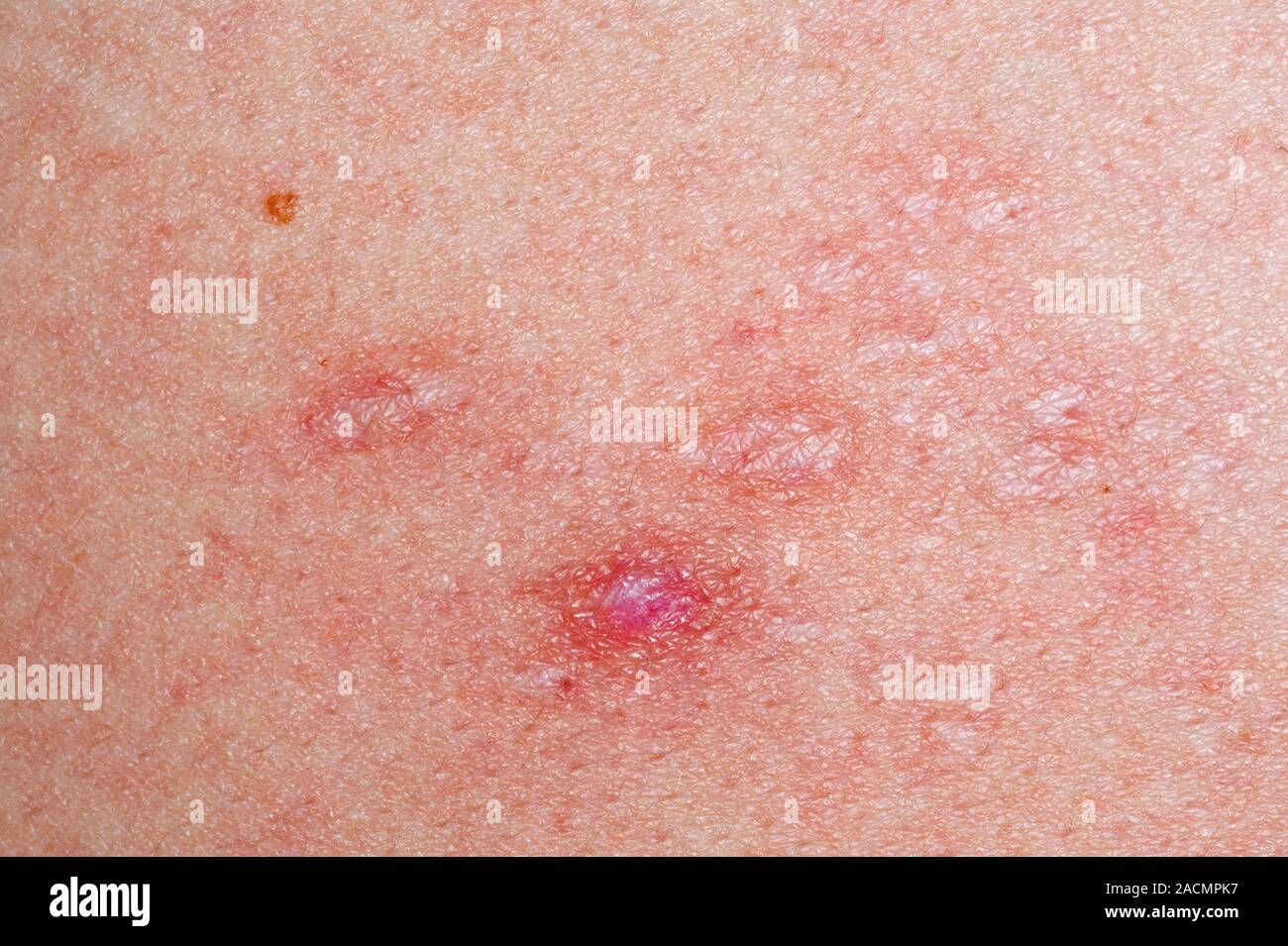 Close-up of scars caused by previous shingles on the skin of the back ...