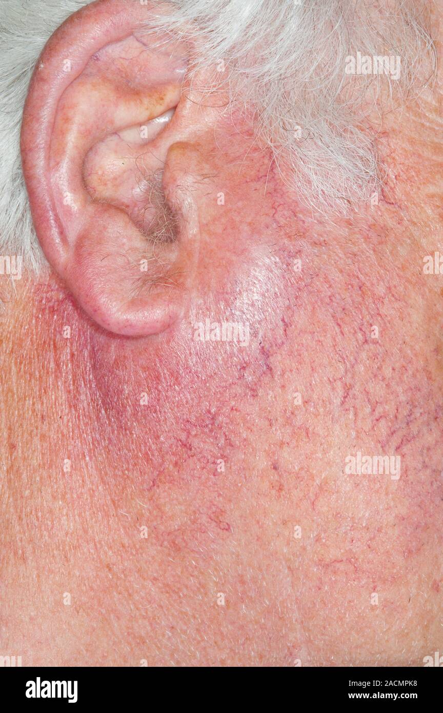 Swollen Parotid Salivary Glands