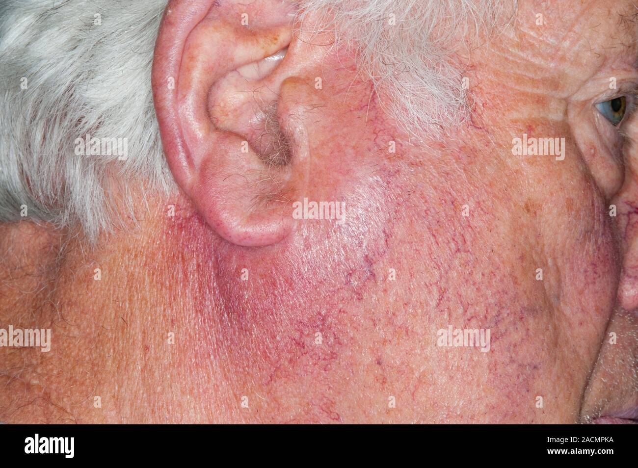 Swollen parotid (salivary) gland below the ear in a 77 year old male ...