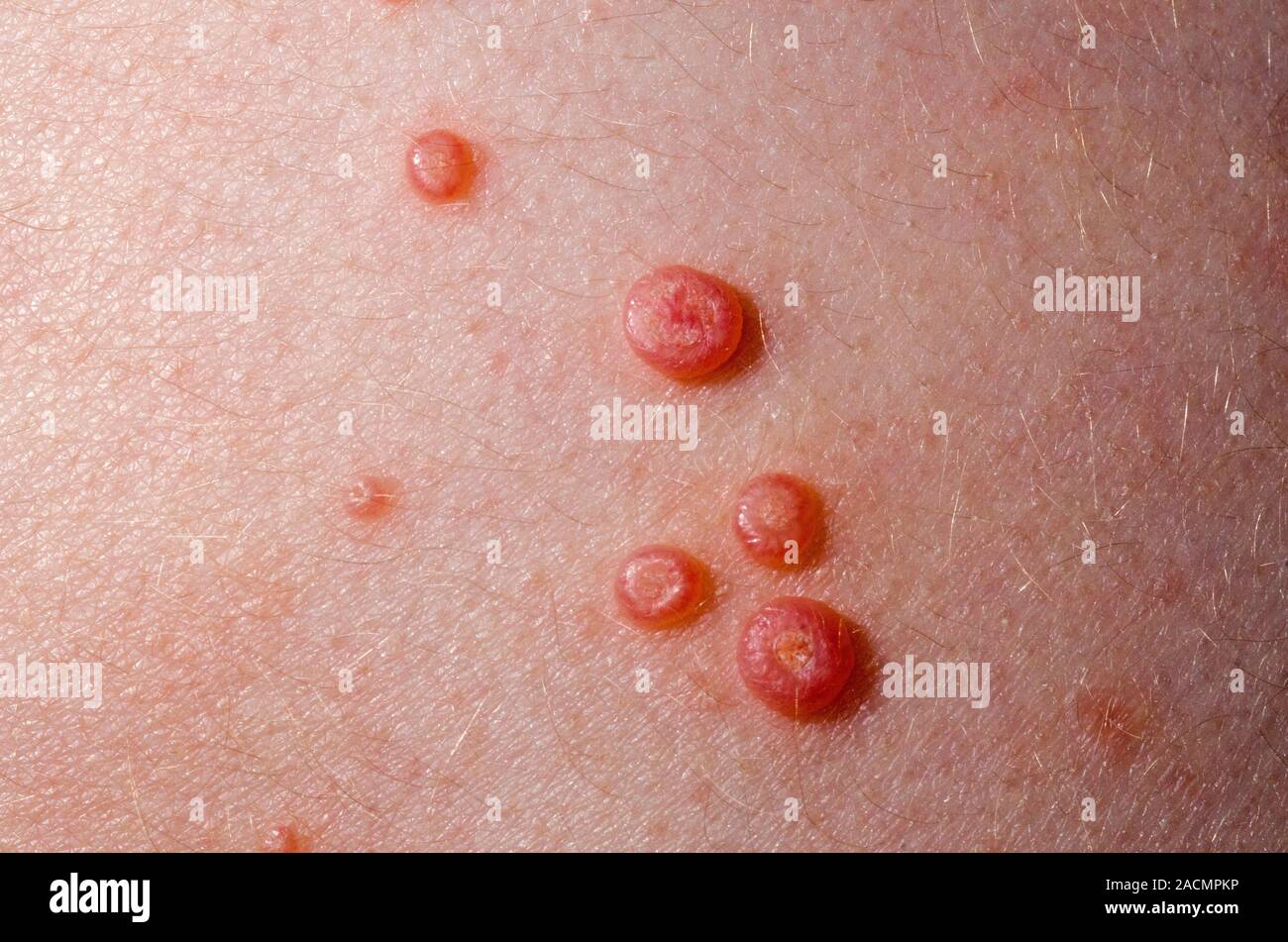 Close-up of skin nodules in a 2 year old female patient with molluscum ...