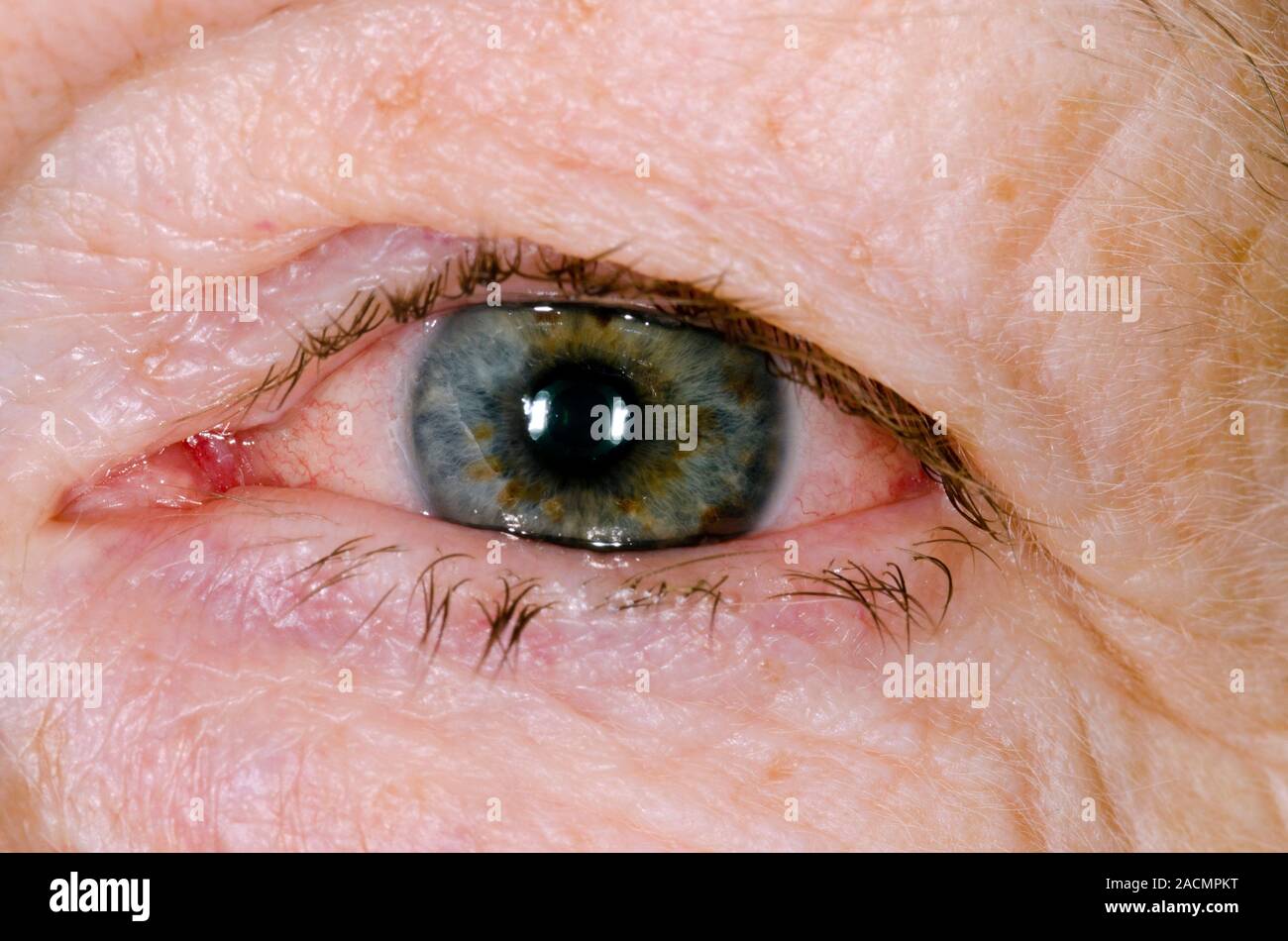 Close-up of the red and inflamed eye (conjunctivitis) in a 65 year old ...