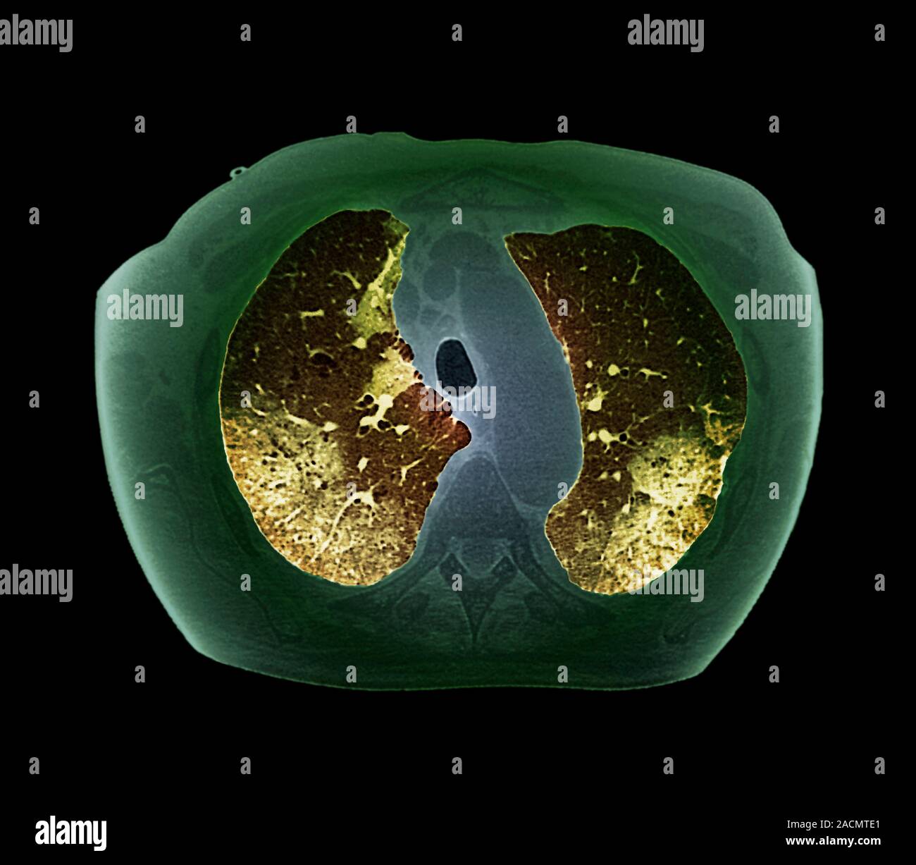 Asbestosis. Coloured computed tomography (CT) scan of a section through ...