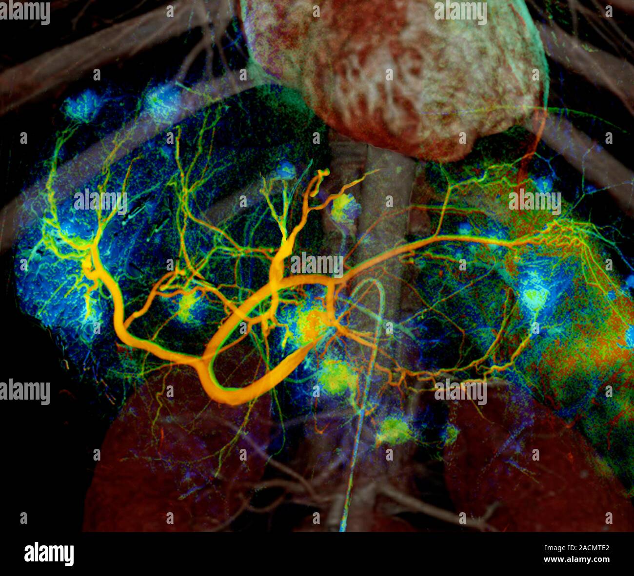 Liver cancer treatment. Coloured computed tomography (CT) scan showing chemoembolisation of ...
