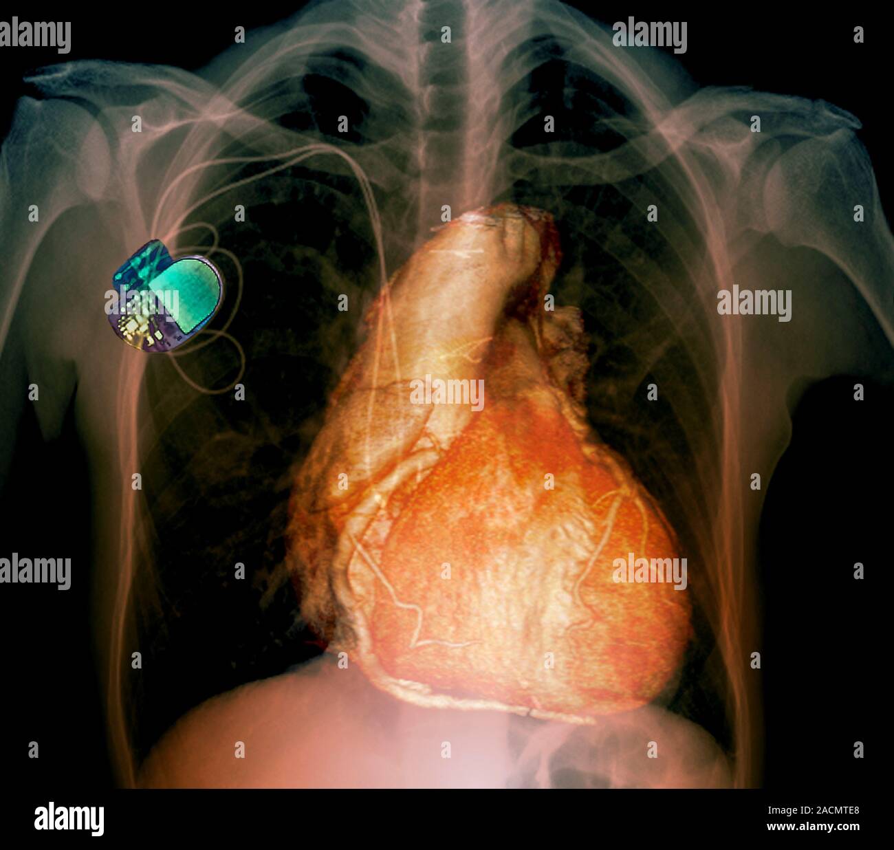 Pacemaker. Coloured frontal 3D computed tomography (CT) scan of the ...