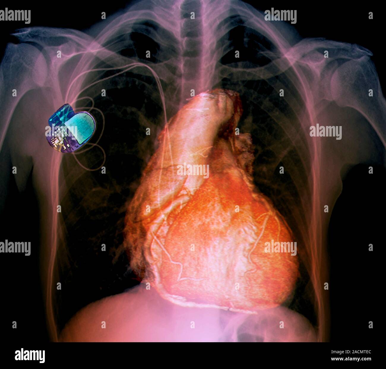 Pacemaker. Coloured frontal 3D computed tomography (CT) scan of the ...