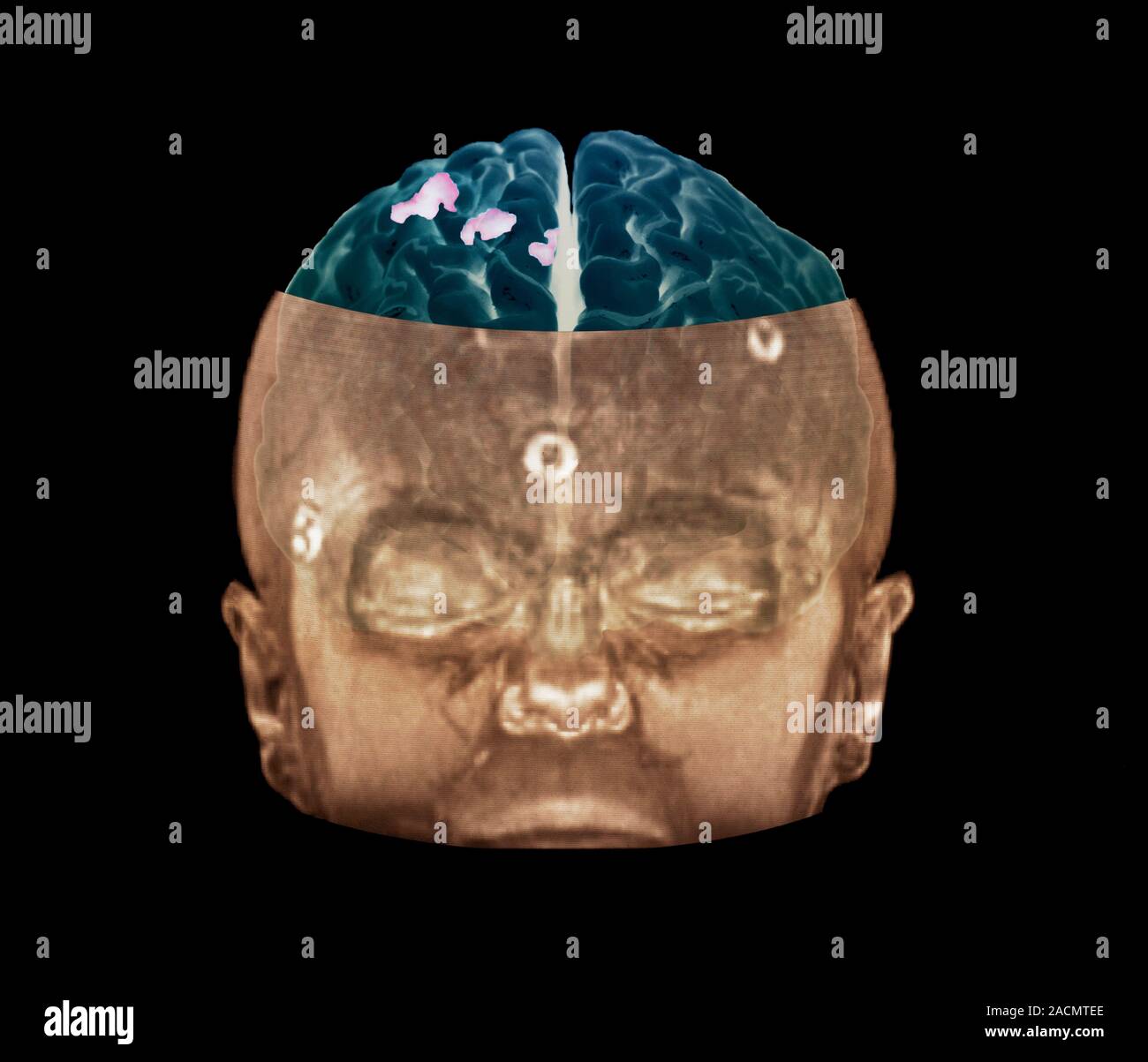 Brain activity. 3D functional magnetic resonance imaging (MRI) scan ...