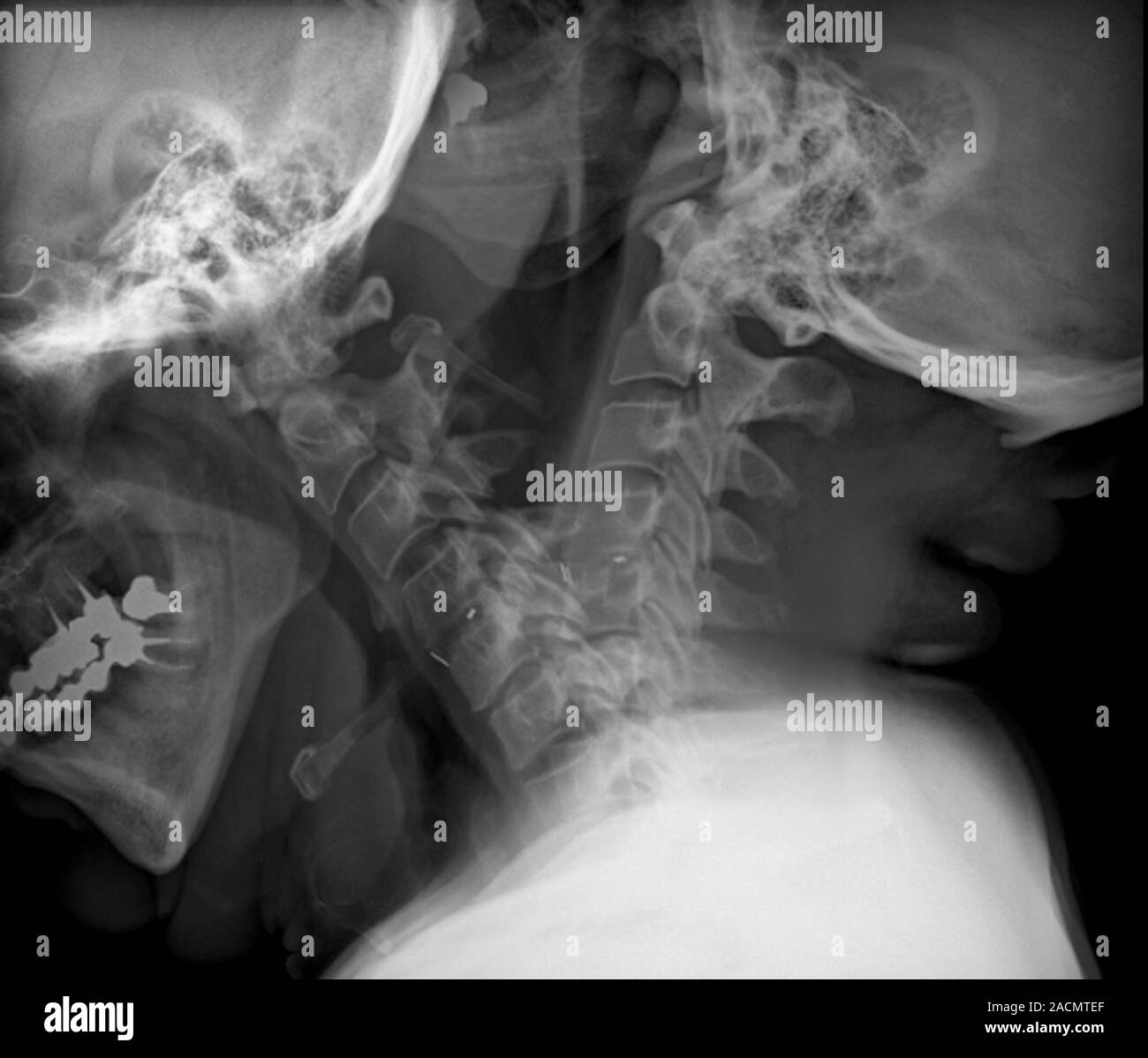 Spine fixation. X-ray image of the neck of a 54-year-old patient with ...