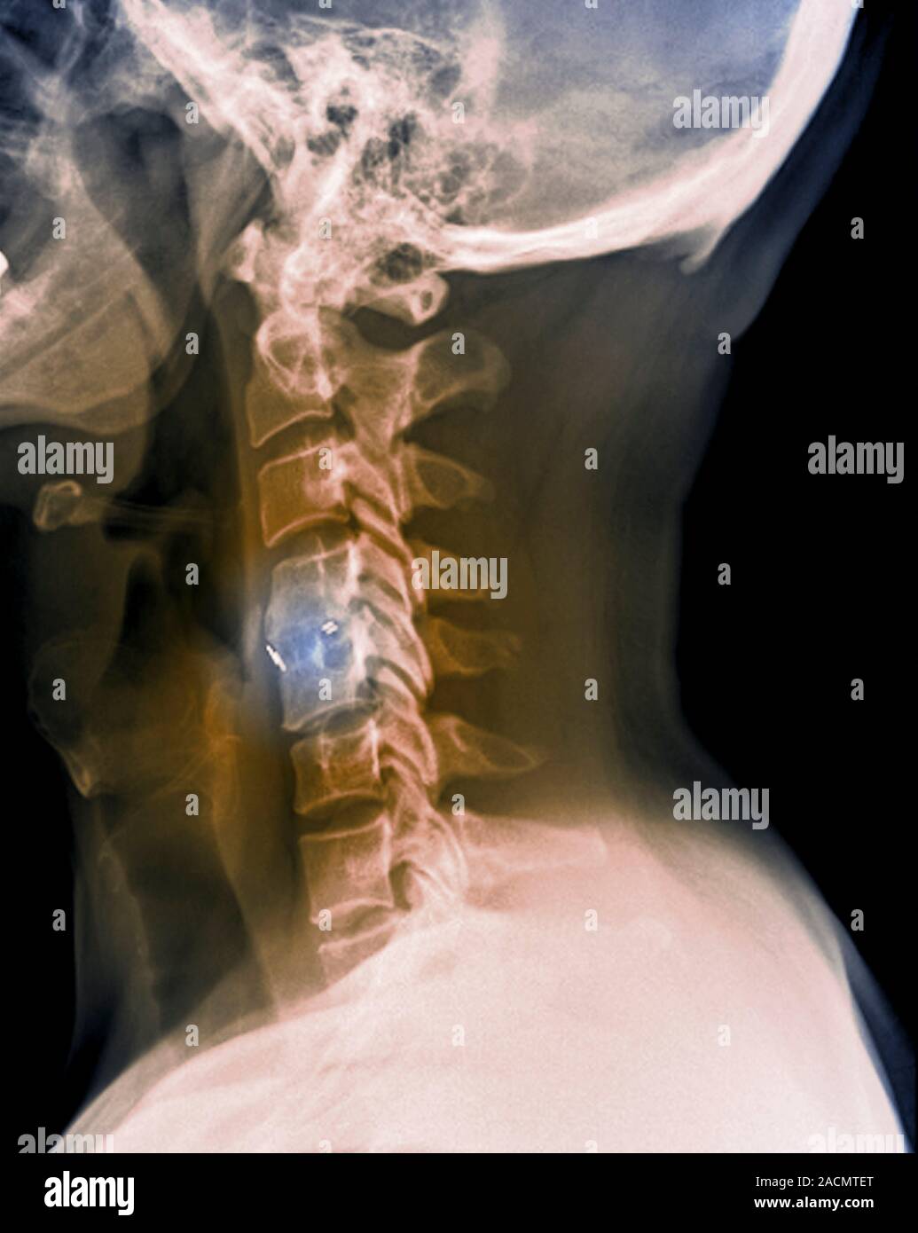 Spine fixation. X-ray image of the neck of a 54-year-old patient with ...