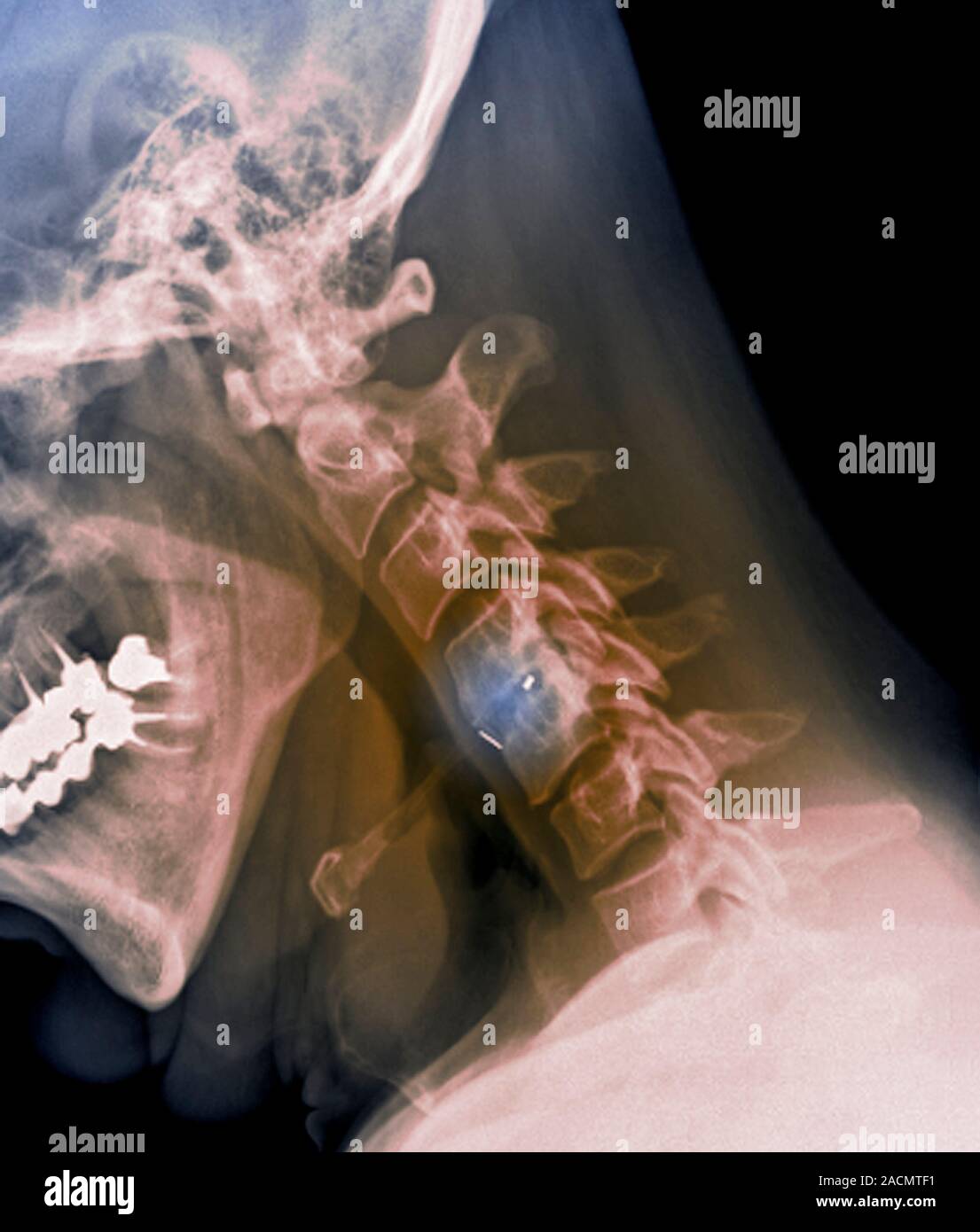 Spine fixation. X-ray image of the neck of a 54-year-old patient with ...