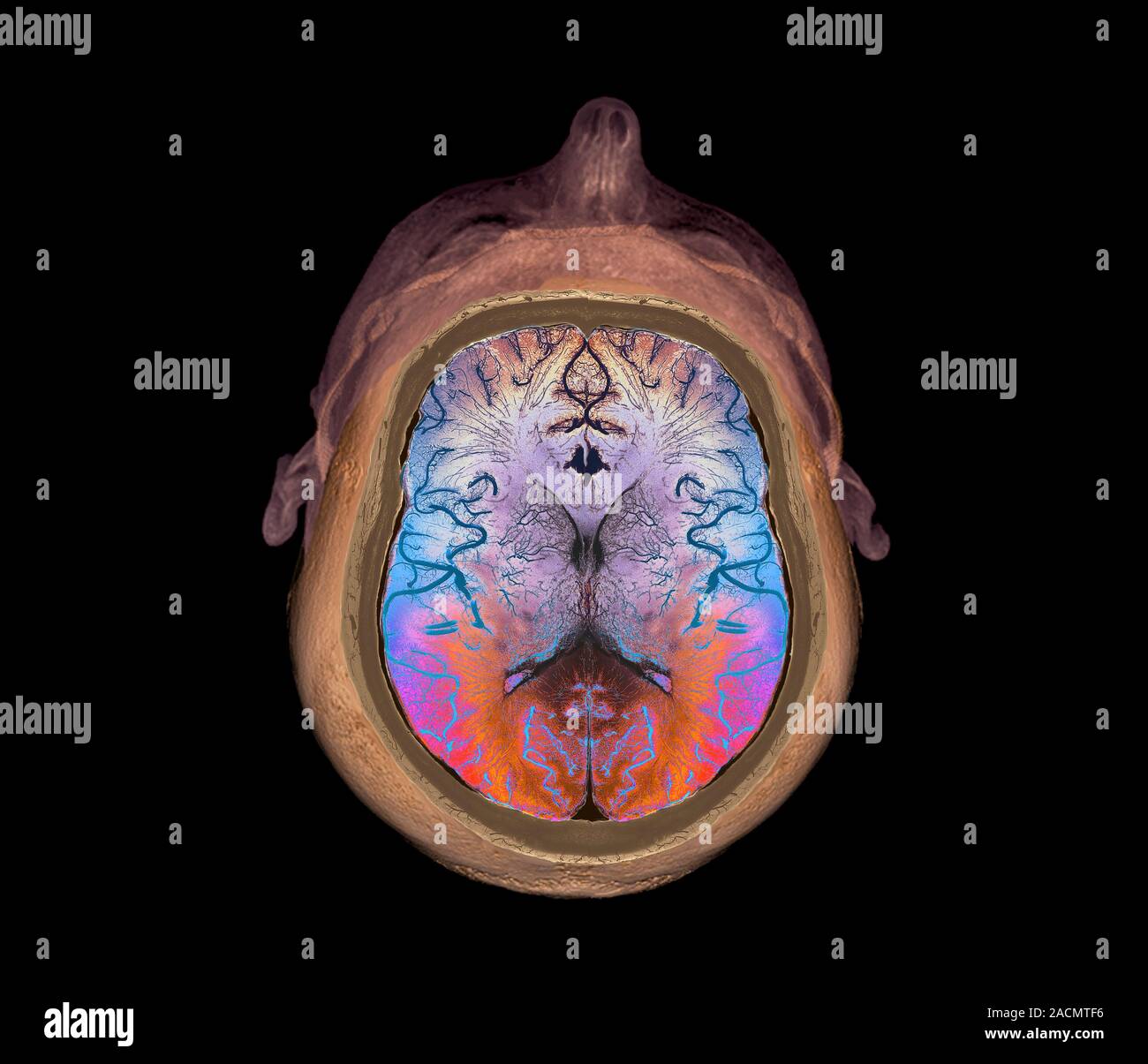 Normal brain. 3D computed tomography (CT) angiogram of a section ...