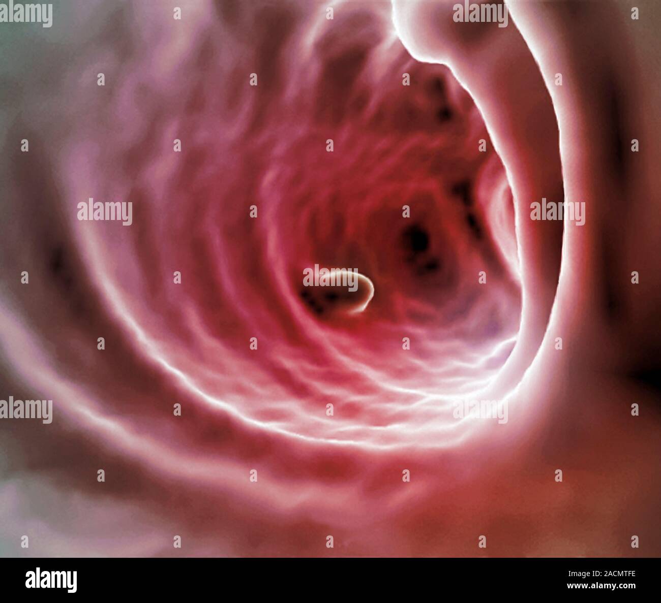 Intestinal polyp. Coloured virtual colonoscopy (VC) image of a sessile ...
