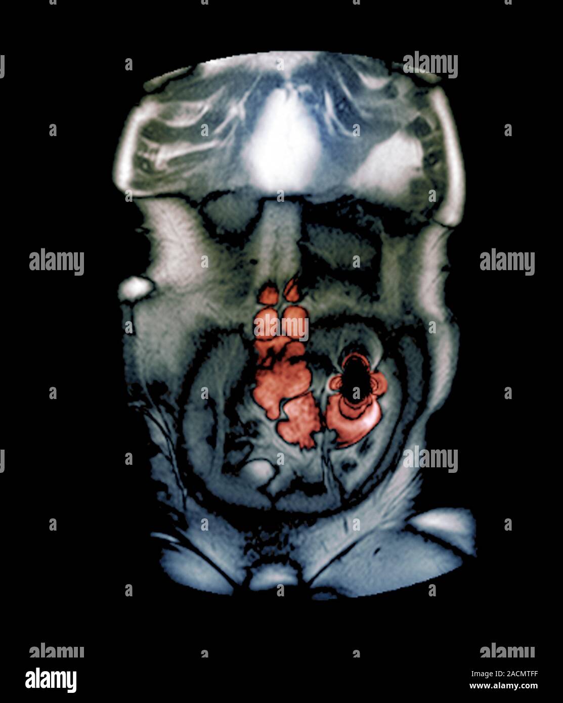 Ileostomy. Coloured magnetic resonance imaging (MRI) scan of the ...