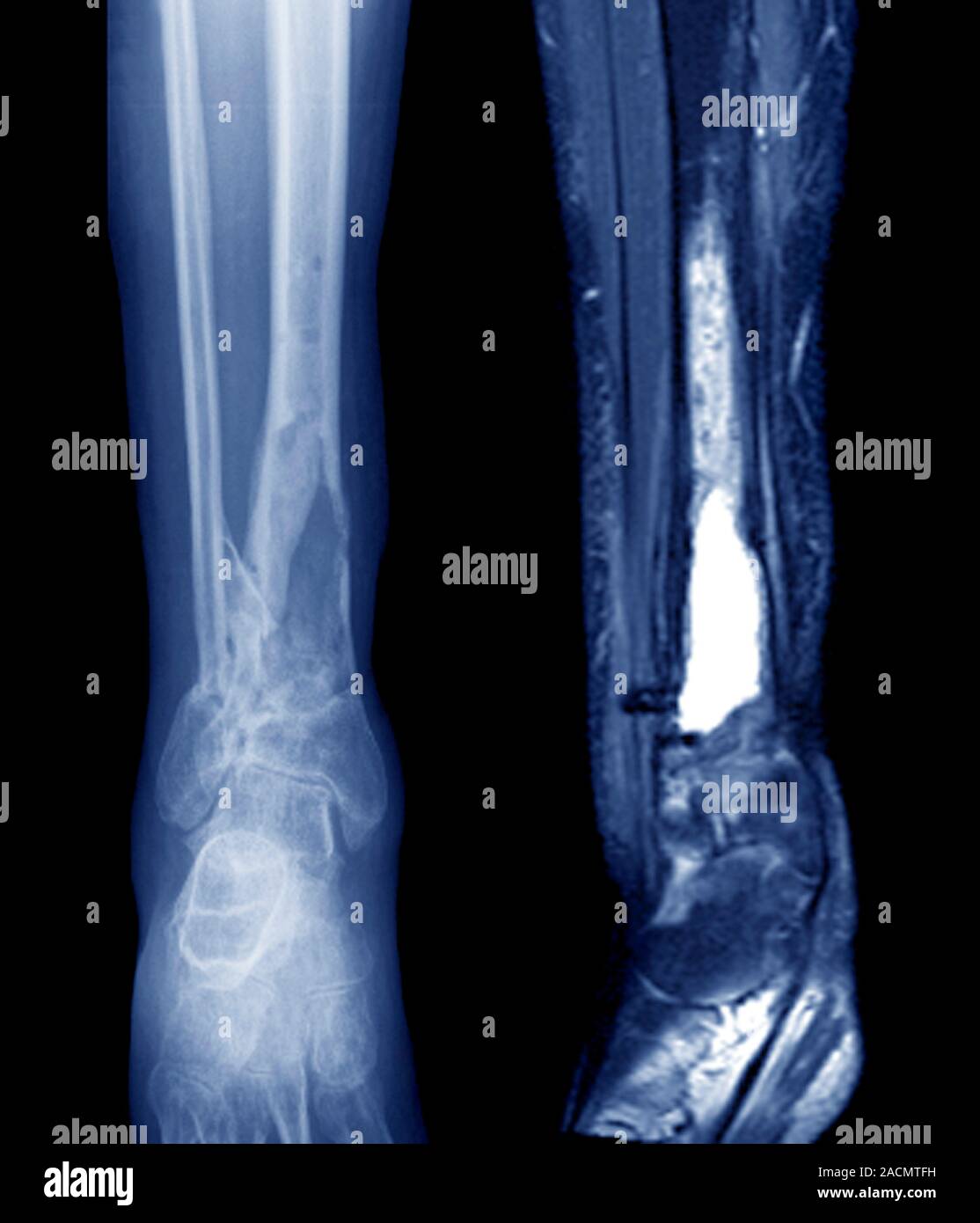 Damaged tibia. X-ray (left) and magnetic resonance imaging (MRI) scan ...