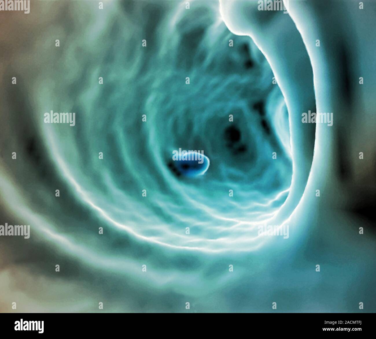 Intestinal polyp. Coloured virtual colonoscopy (VC) image of a sessile ...