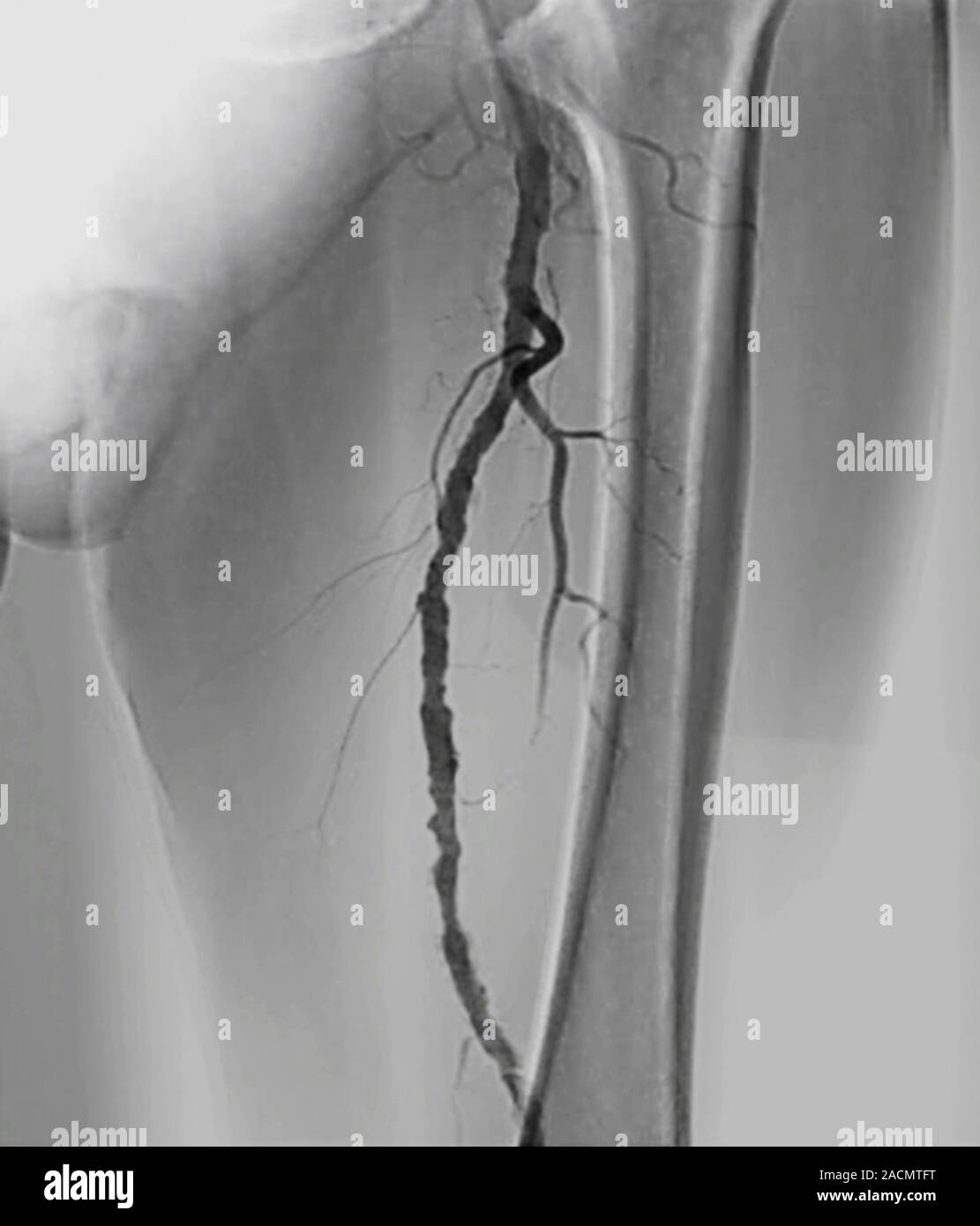 Atherosclerosis. X-ray angiogram of a 62-year-old patient's left leg ...