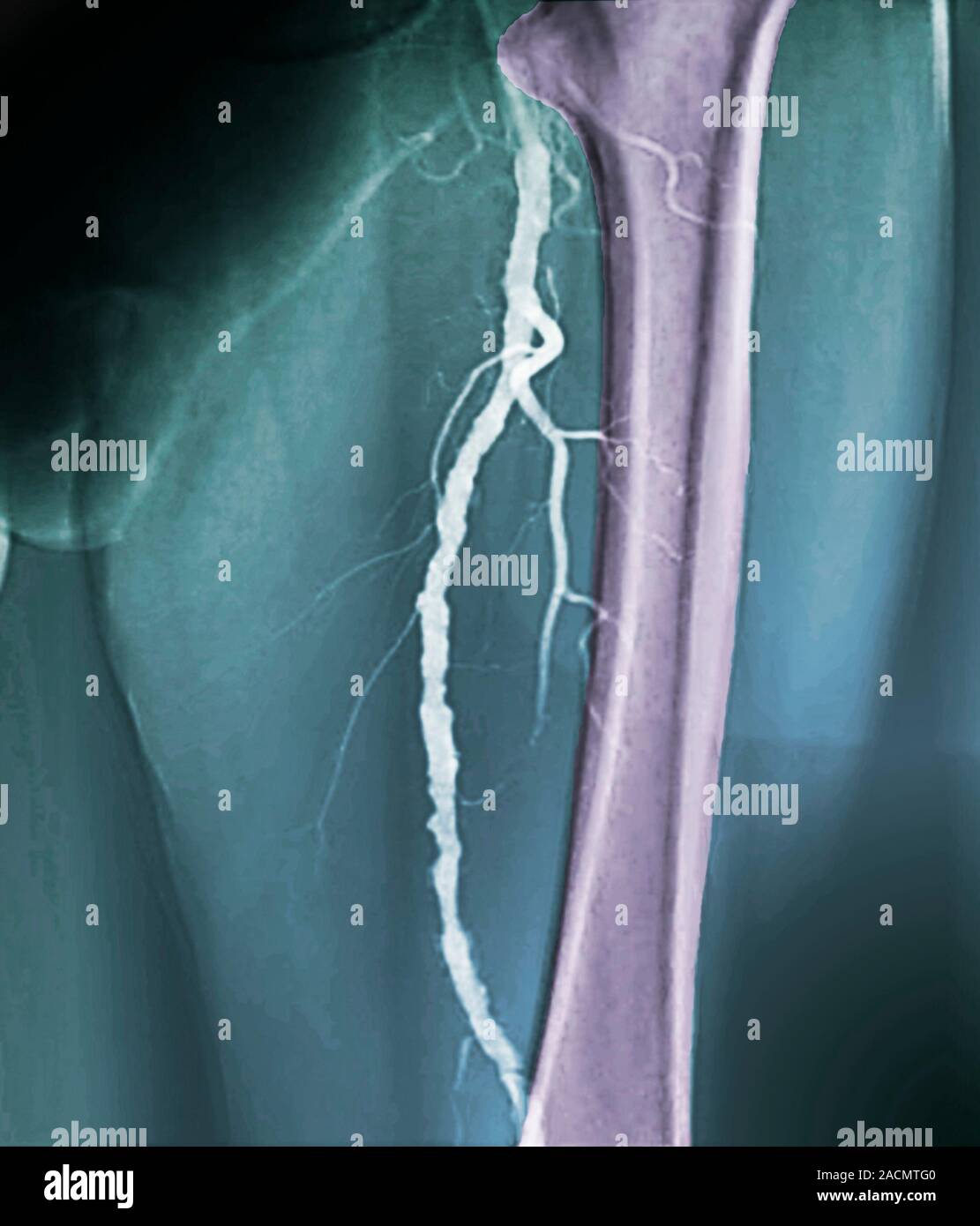 Atherosclerosis. X-ray angiogram of a 62-year-old patient's left leg ...