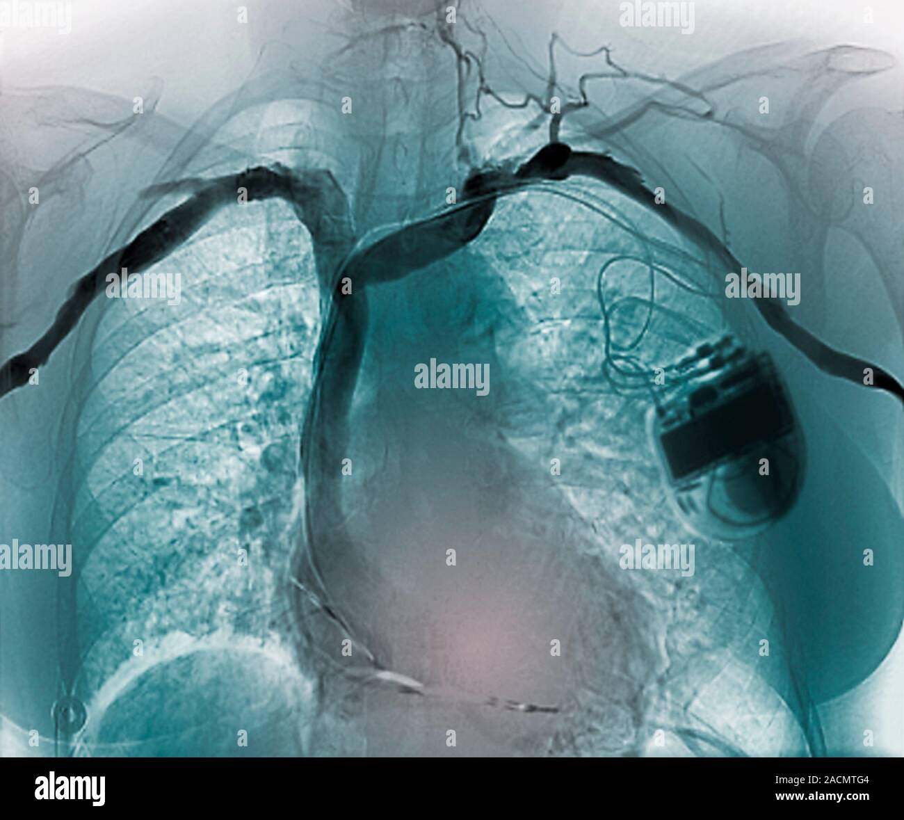 Pacemaker. Coloured chest X-ray angiogram of a 74-year-old patient with ...