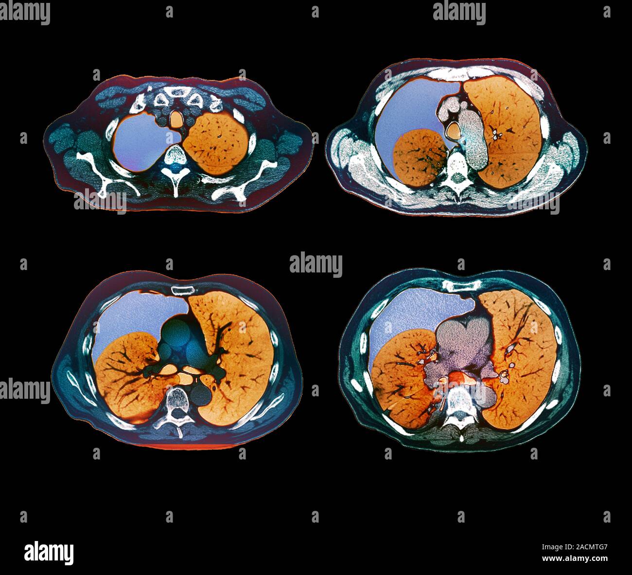 Pneumothorax. Coloured computed tomography (CT) scans of axial sections ...