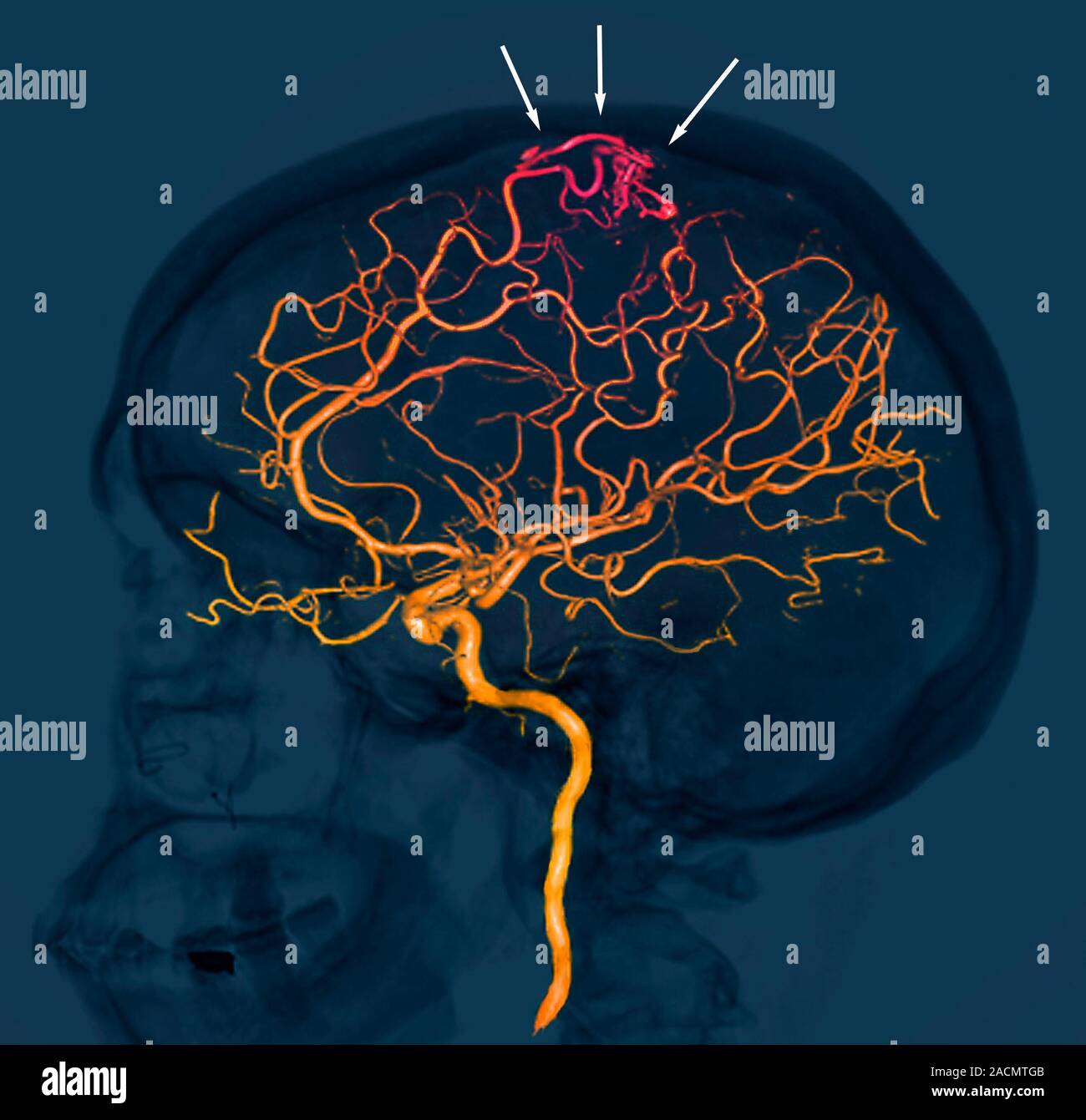 Brain vascular abnormality. Coloured 3D computed tomography (CT ...