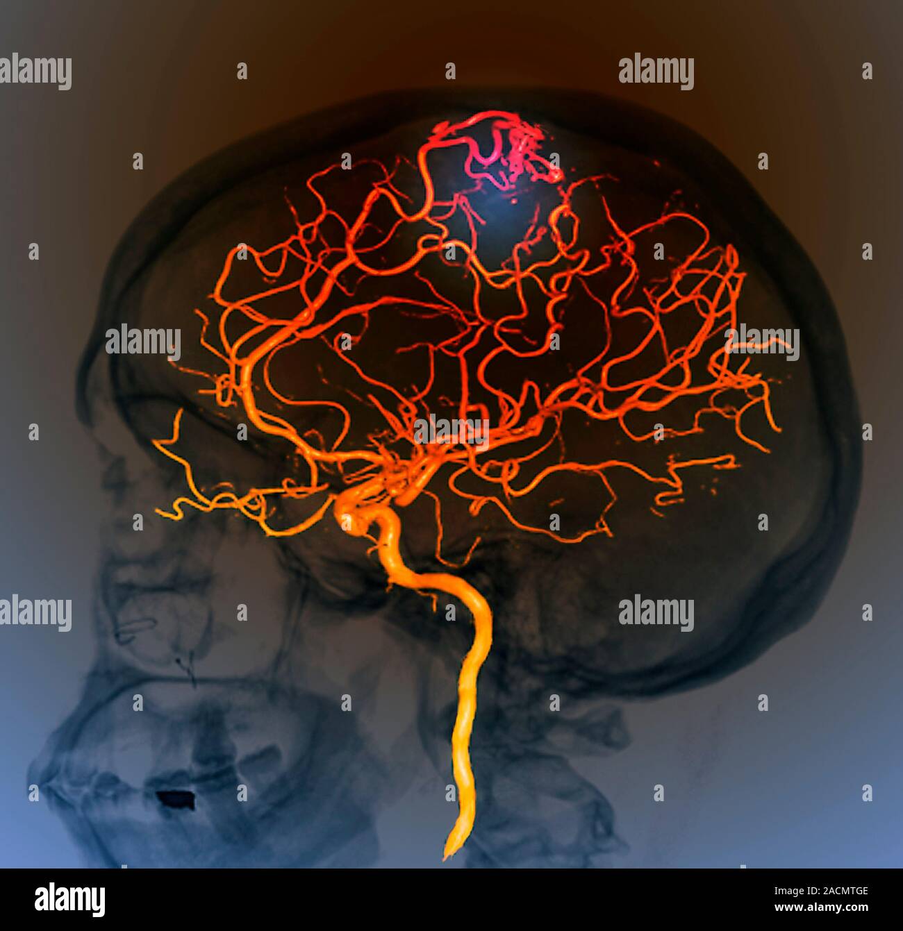Brain vascular abnormality. Coloured 3D computed tomography (CT) angiogram of the blood vessels ...