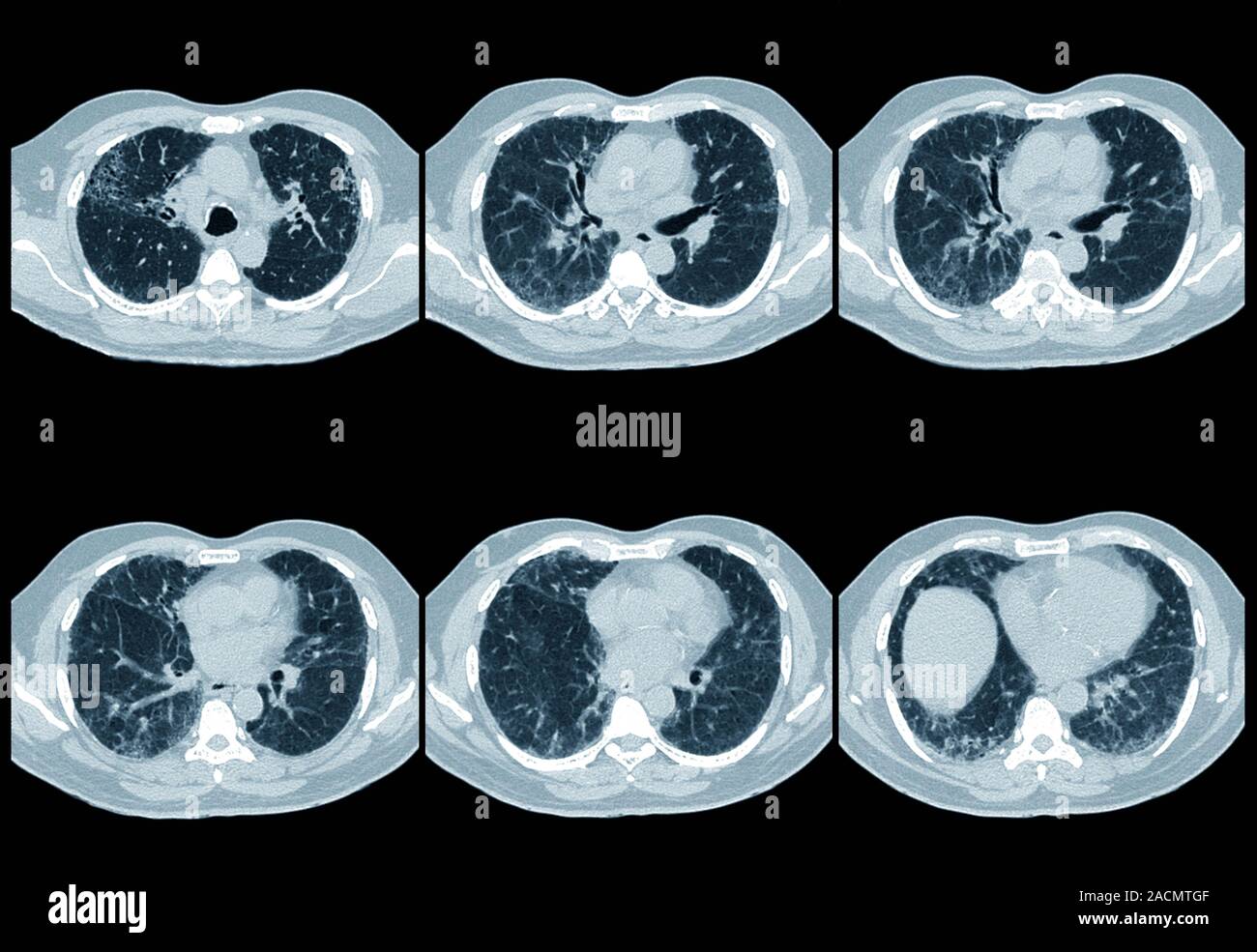 Interstitial lung disease. Coloured computed tomography (CT) scans of ...