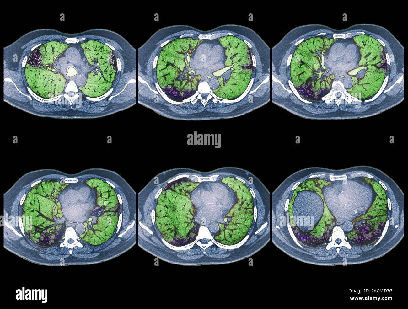Interstitial lung disease. Coloured computed tomography (CT) scans of ...