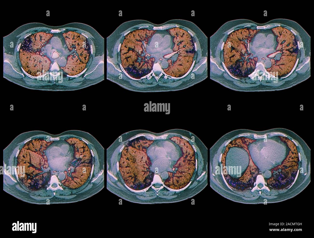 Interstitial lung disease. Coloured computed tomography (CT) scans of ...
