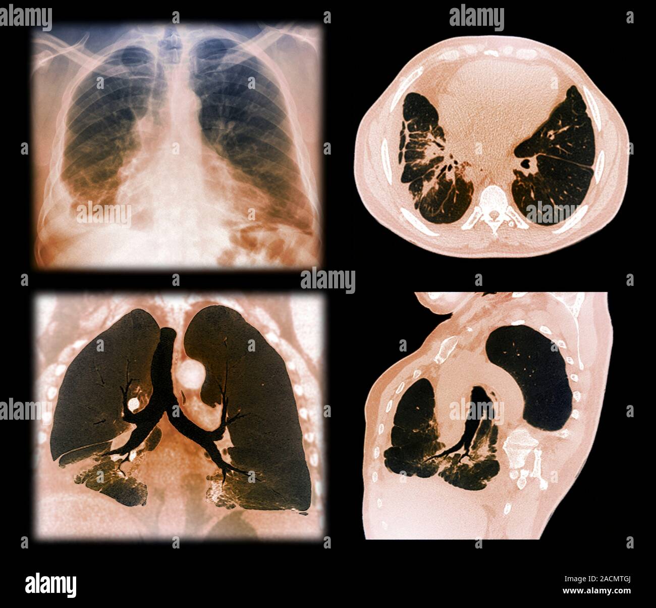 Kaposis Sarcoma Of The Lung Coloured Computed Tomography Ct Scans Of Sections Through The
