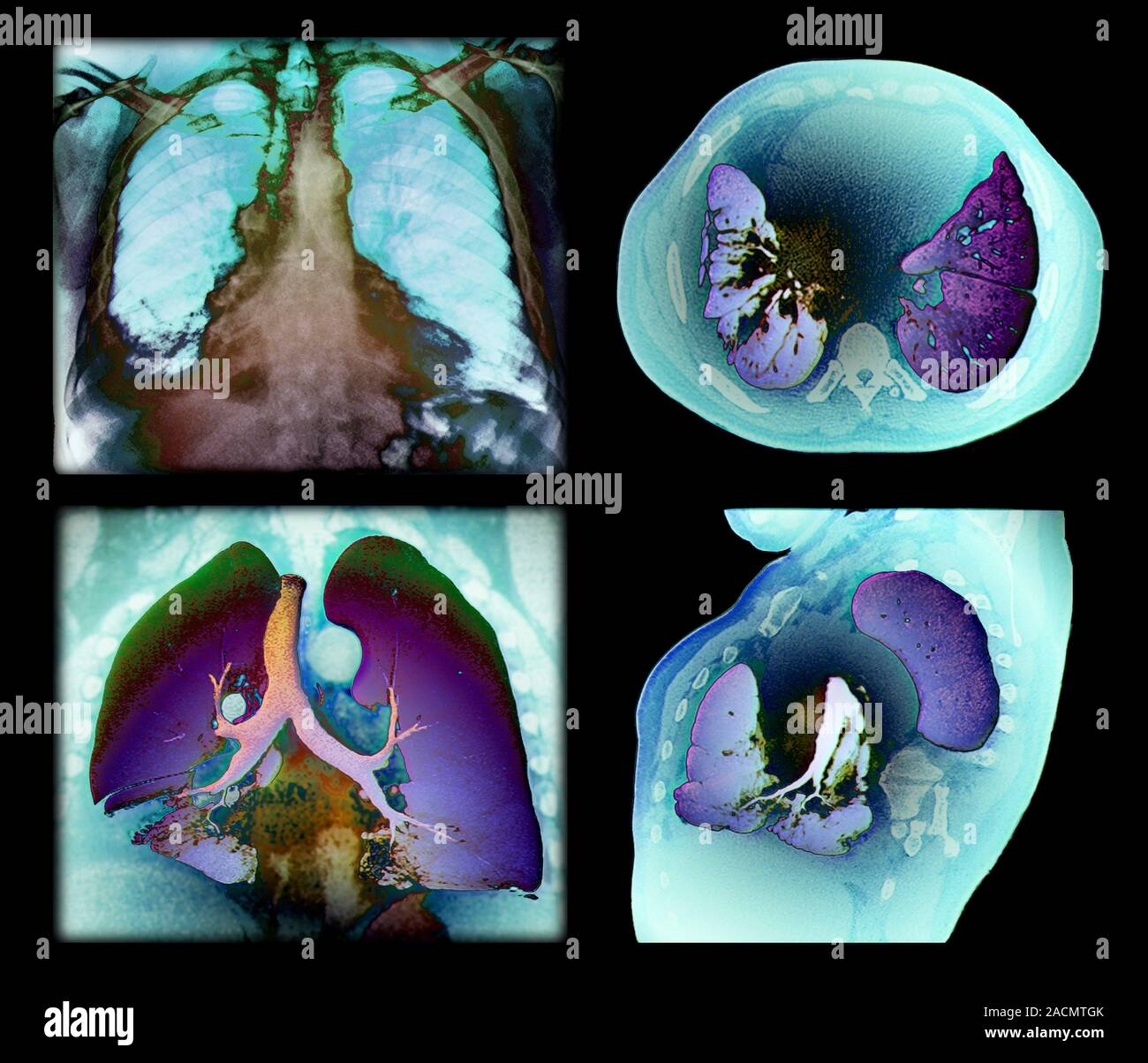 Kaposis Sarcoma Of The Lung Coloured Computed Tomography Ct Scans Of Sections Through The