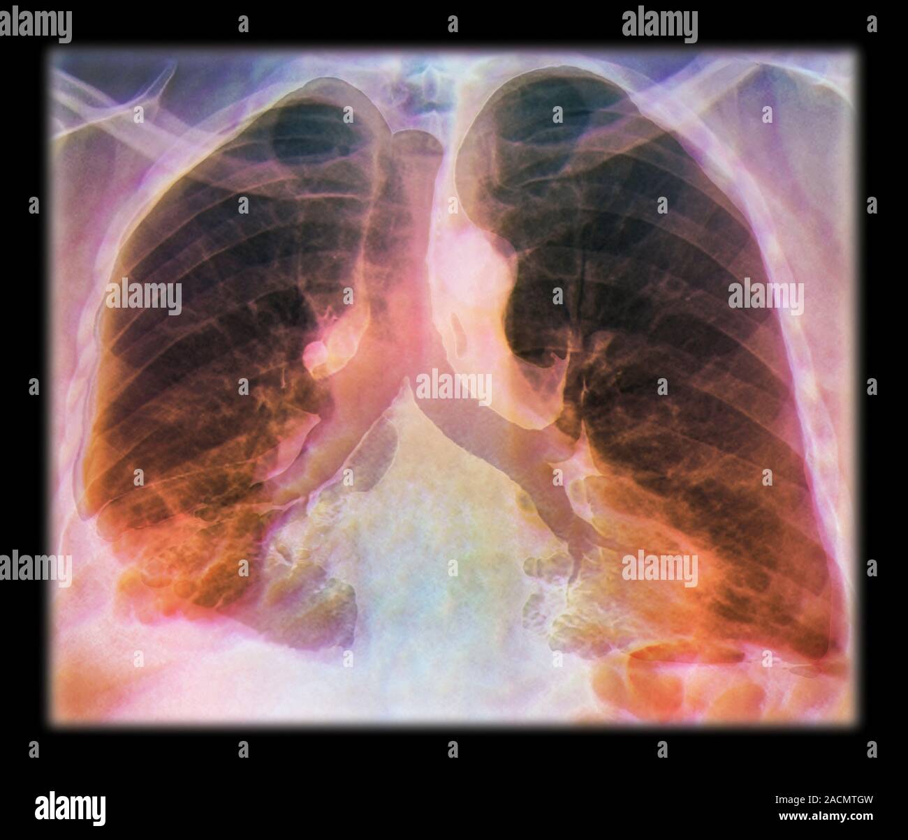 Kaposi's sarcoma of the lung. Coloured computed tomography (CT) scan of ... Kaposi's sarcoma of the lung. Coloured computed tomography (CT) scan of ...