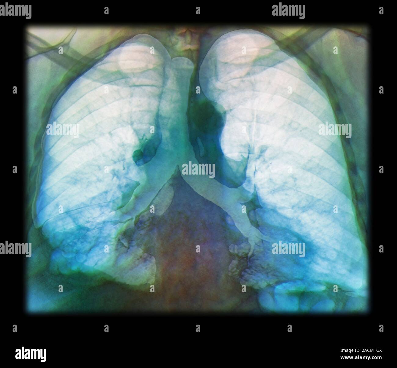 Kaposis Sarcoma Of The Lung Coloured Computed Tomography Ct Scan Of A Section Through The