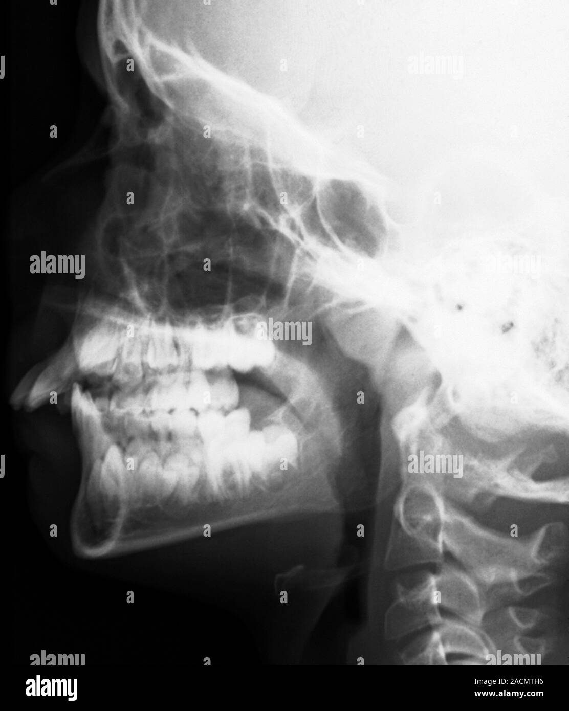 Adenoid hypertrophy in a child. X-ray through the nasopharyngeal region ...