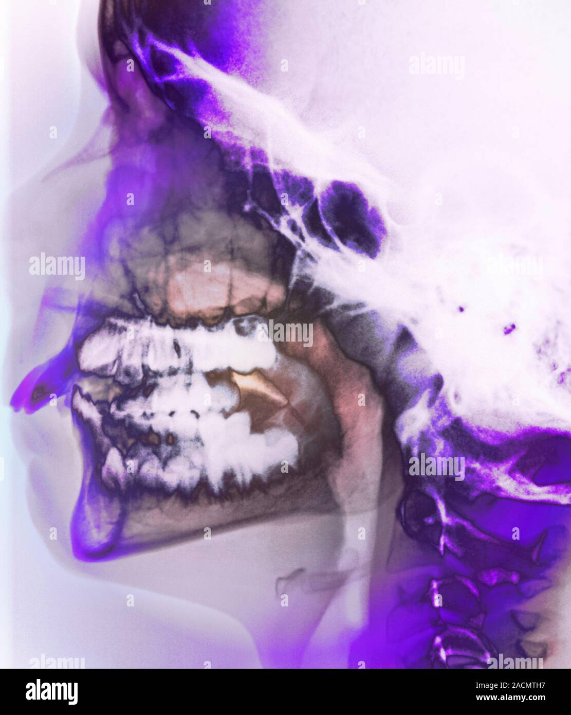 Adenoid hypertrophy in a child. Coloured X-ray through the ...