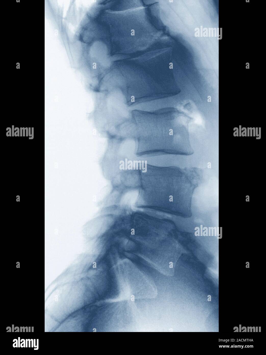 Scheuermann's disease. Coloured X-ray of the lumbar (lower back ...